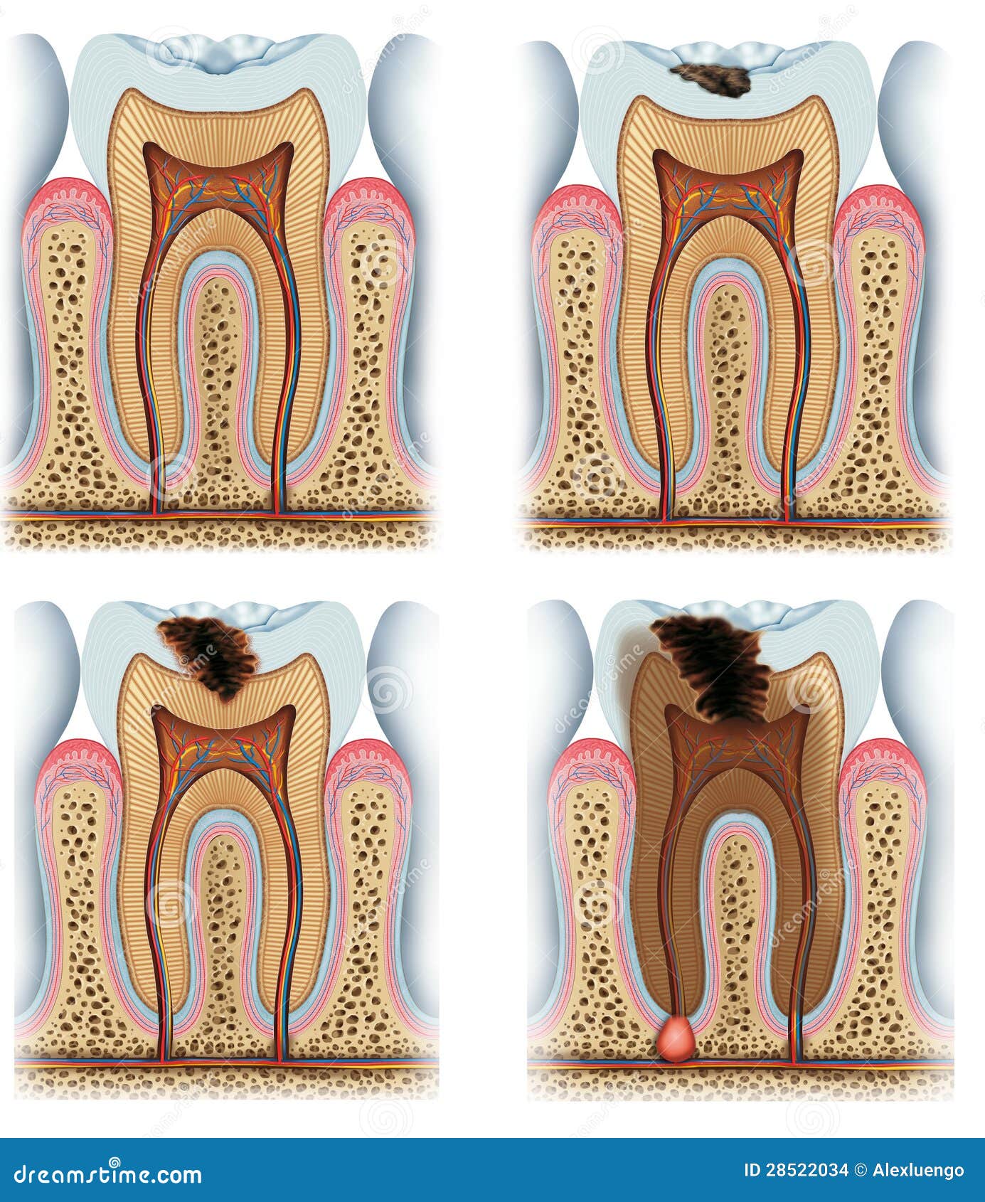 Stages of tooth caries stock illustration. Illustration of blood - 28522034
