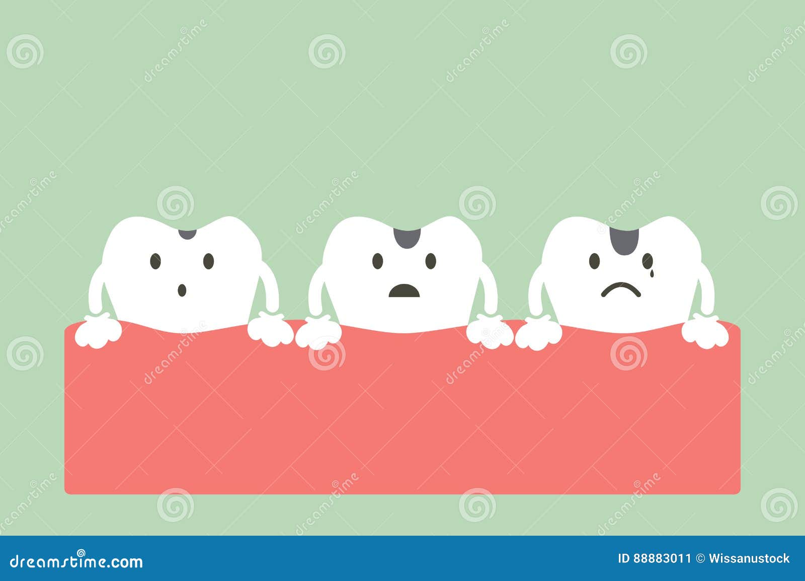 Stages of tooth decay stock vector. Illustration of damage - 88883011