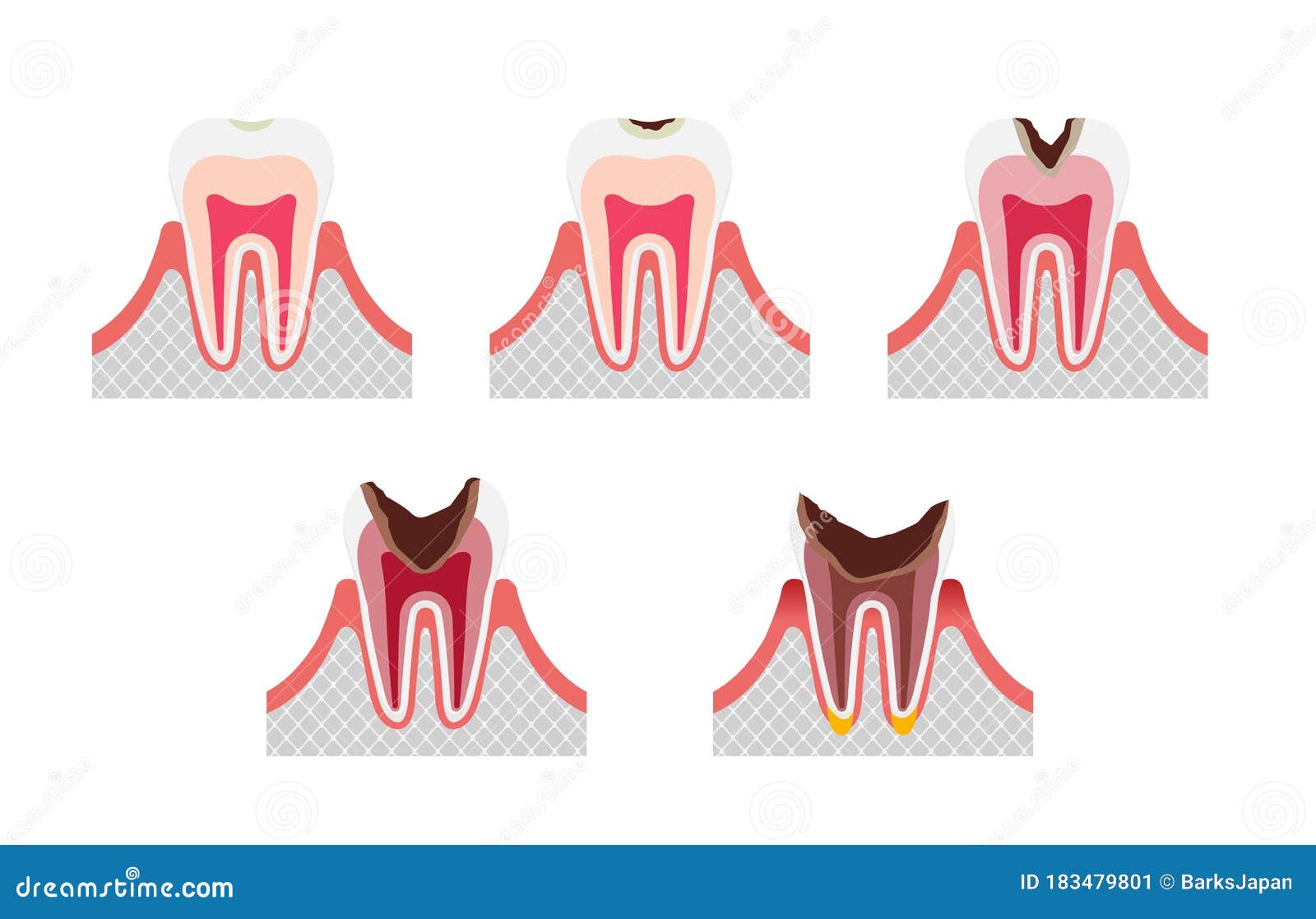 The Stages Of Tooth Decay / Flat Vector Illustration Set ...