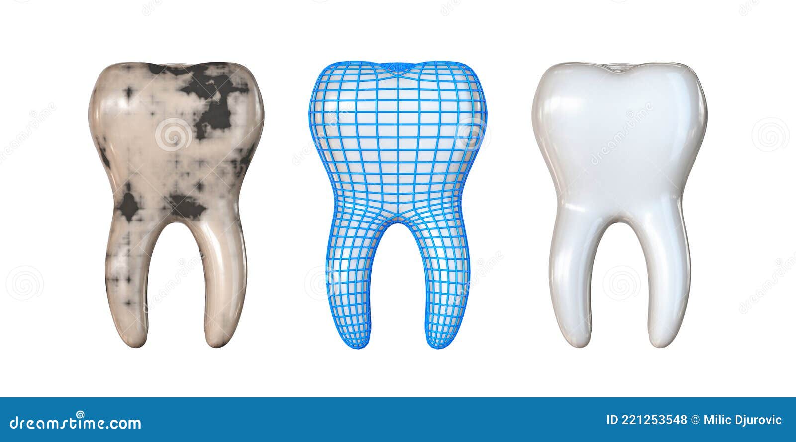 The Stages Of Tooth Decay Infographic. Dental Toothache Symbol Vector ...