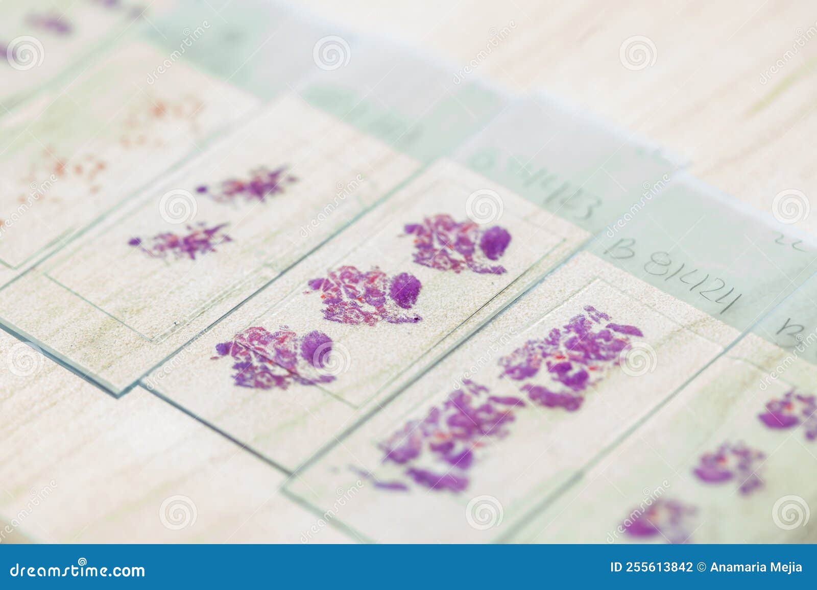 Stained Tissue Biopsy on Glass Slides in Pathology Laboratory Stock ...