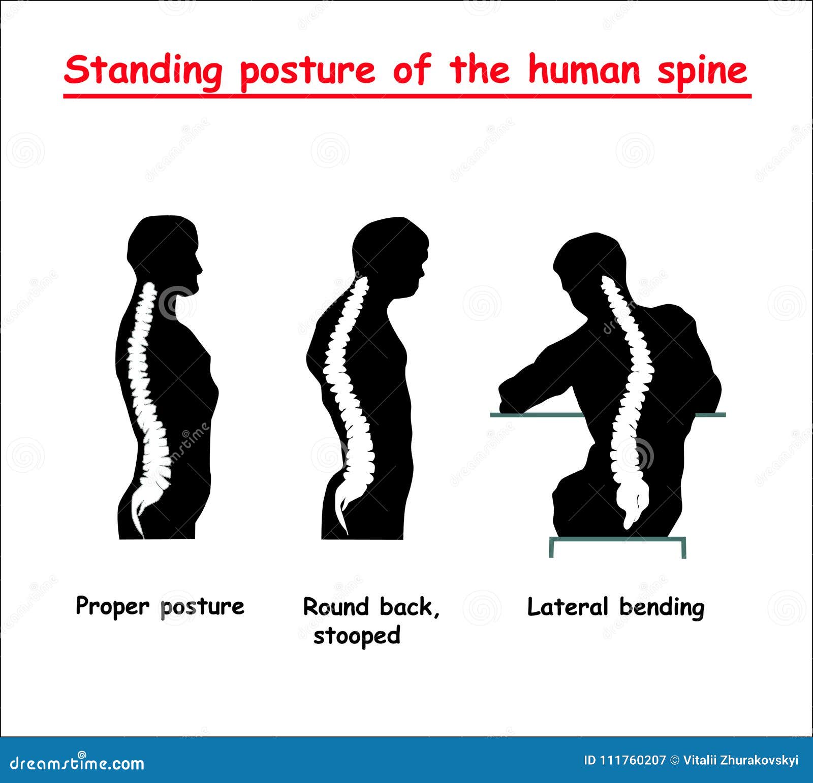 Standing Posture of the Black Human Spine. Defects of the Human Spine ...