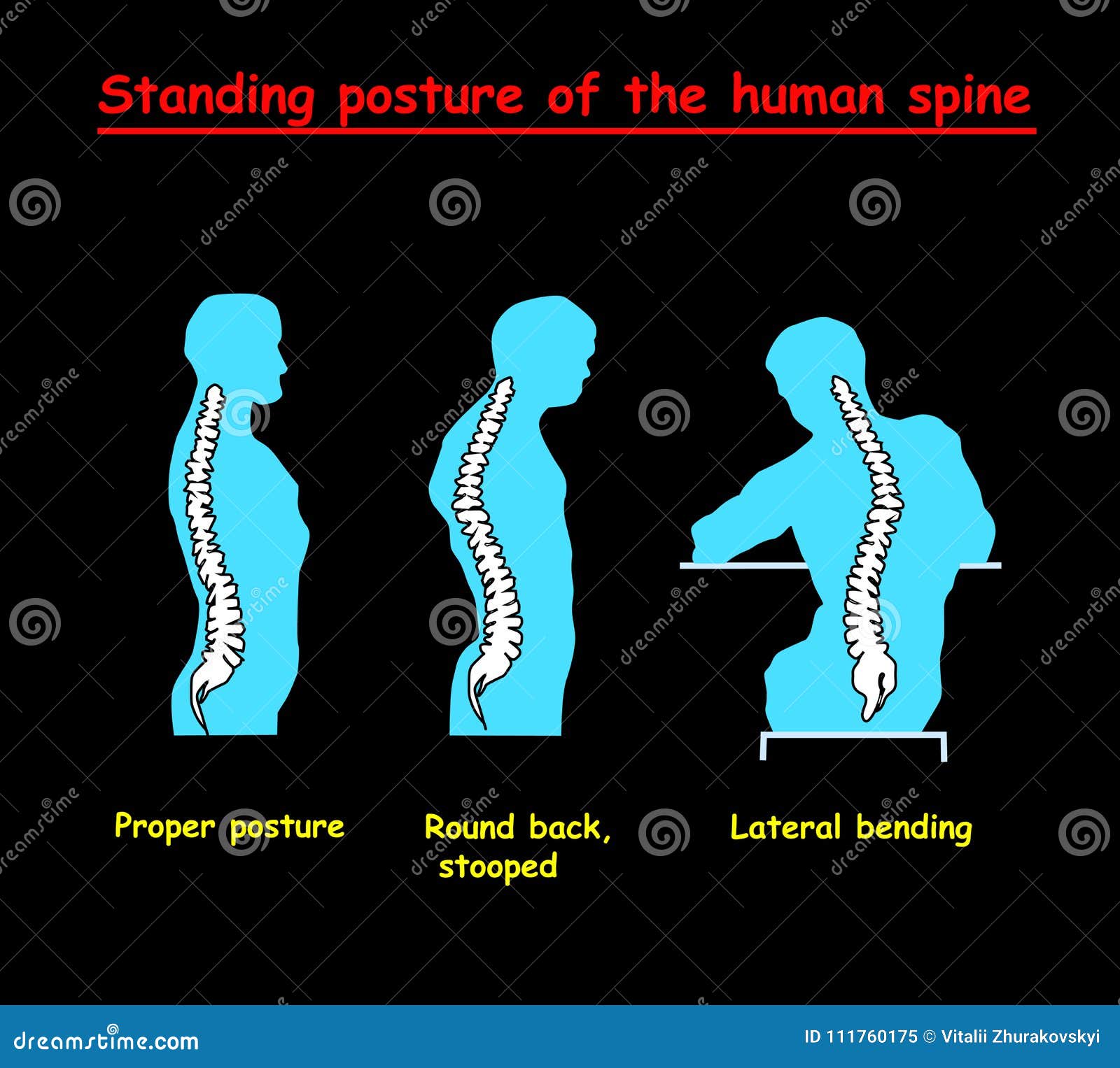 Standing Posture of the Blue Human Spine. Defects of the Human Spine ...
