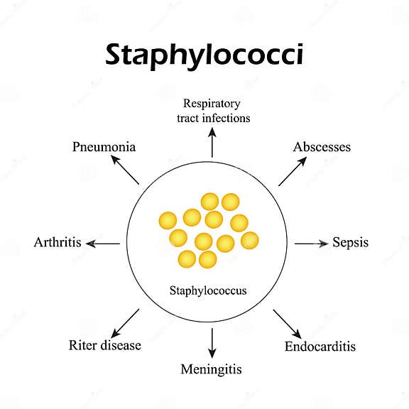Staphylococci. Staphylococcus Aureus Causes Diseases. Infographics ...
