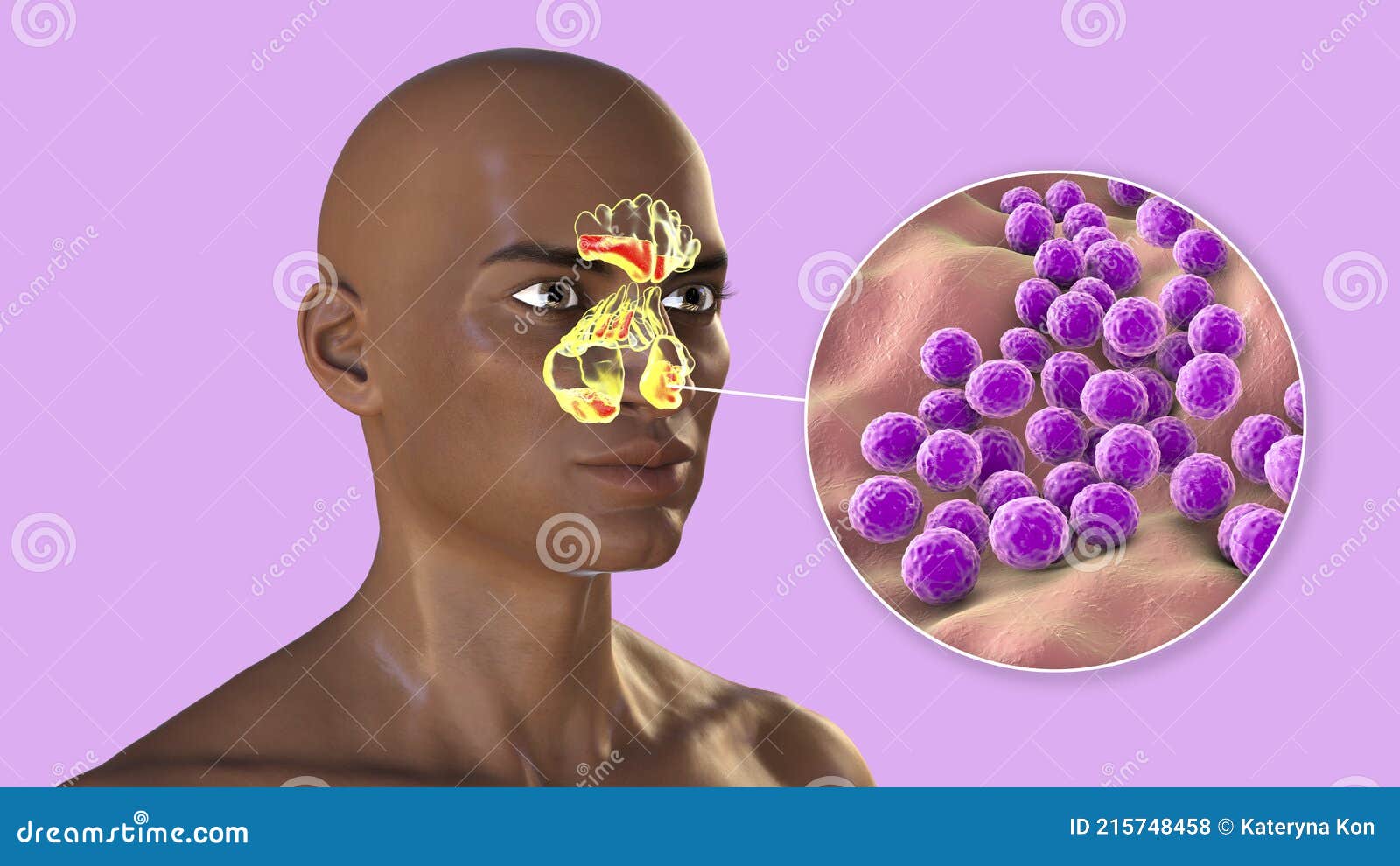 Staphylococcus Aureus Cell Structure And Pathogenic Factors Cartoon ... Staphylococcus Aureus Cell Structure And Pathogenic Factors Cartoon ...