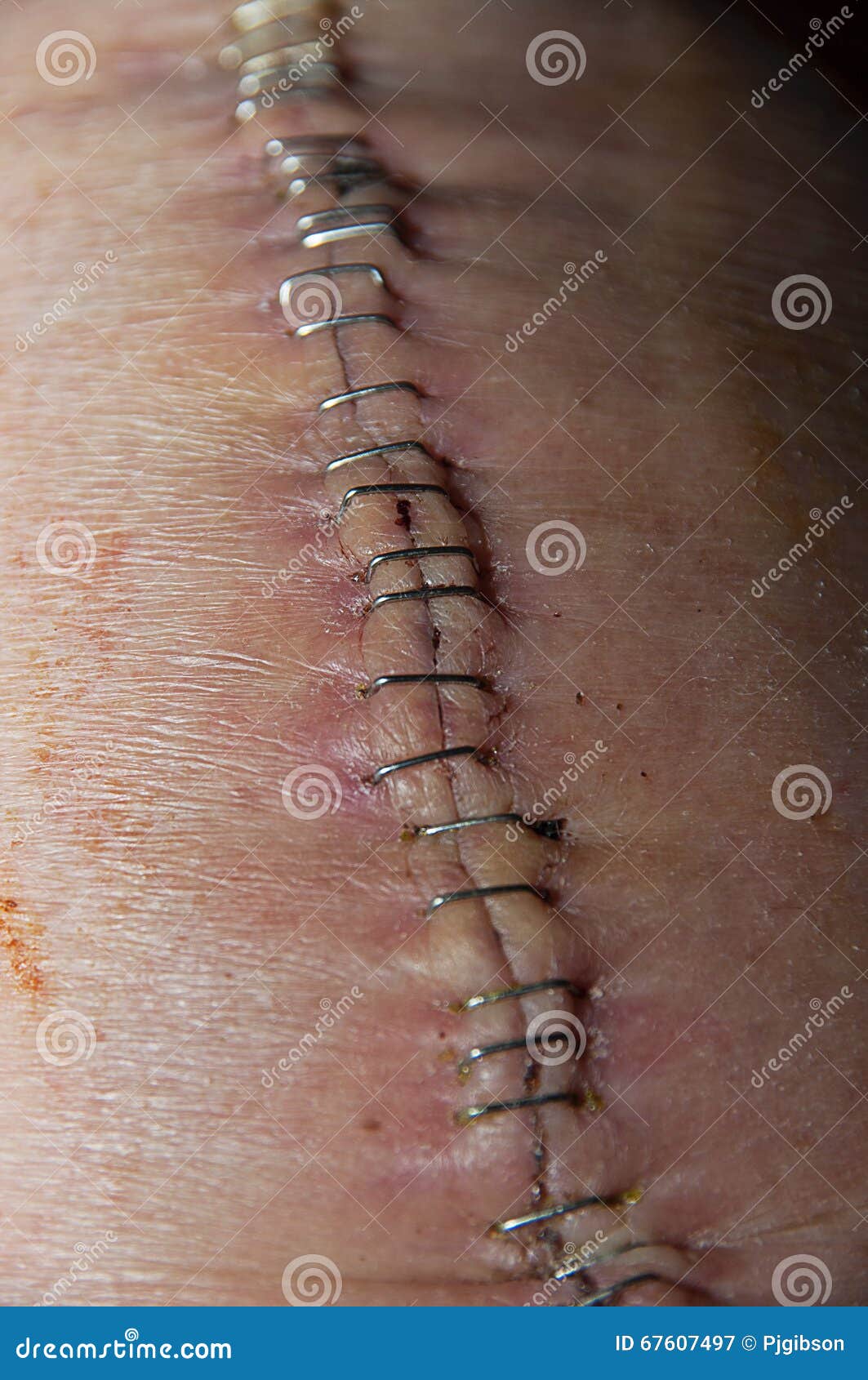Staples stock image. Image of stitches, hospital, colour - 67607497