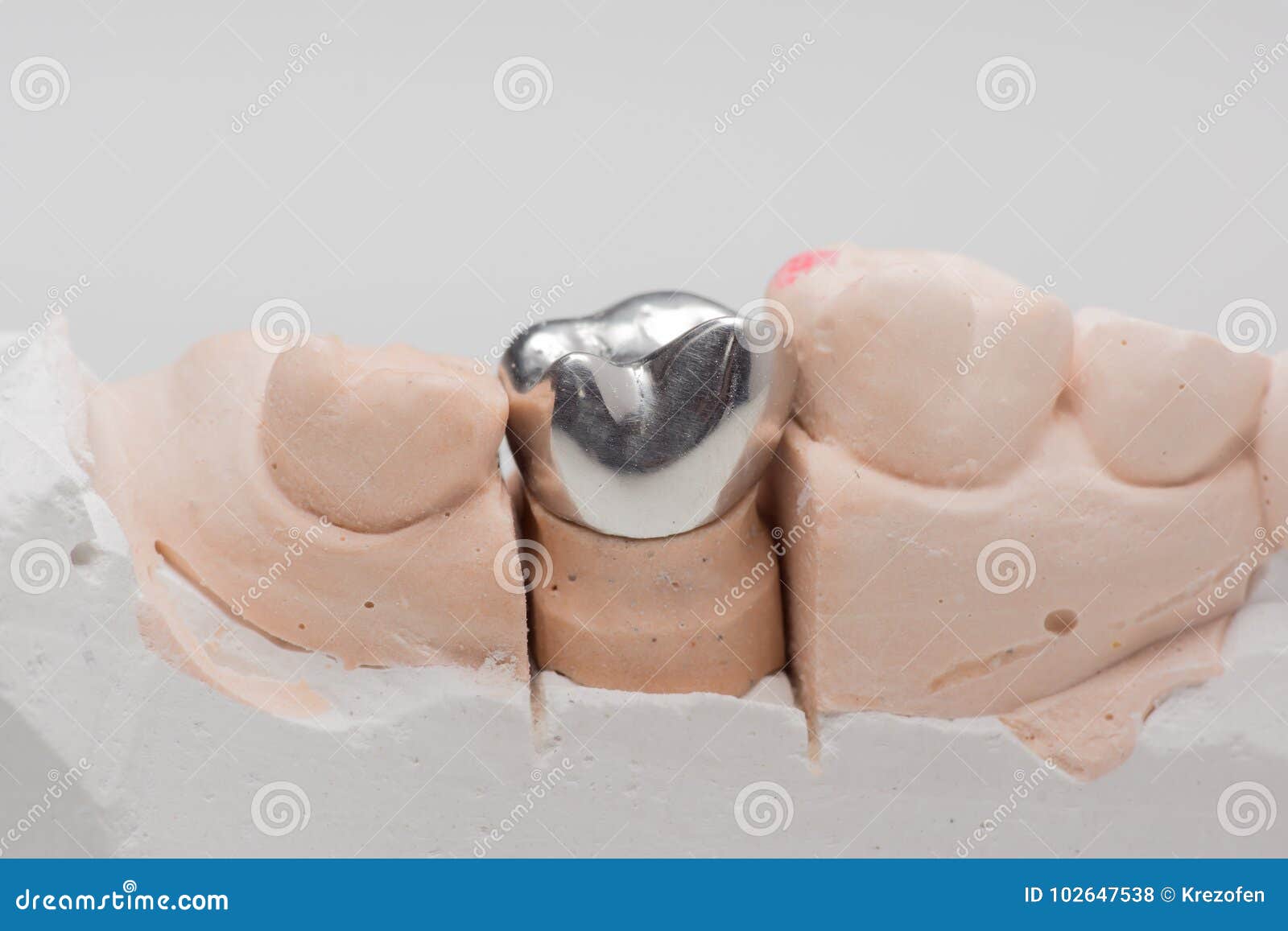 Artificial tooth crown stock photo. Image of orthodontist - 102647538
