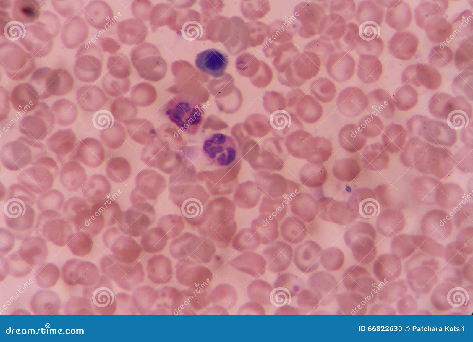 Nucleated Red Blood Cells NRC In Blood Smear Stock Photo ...