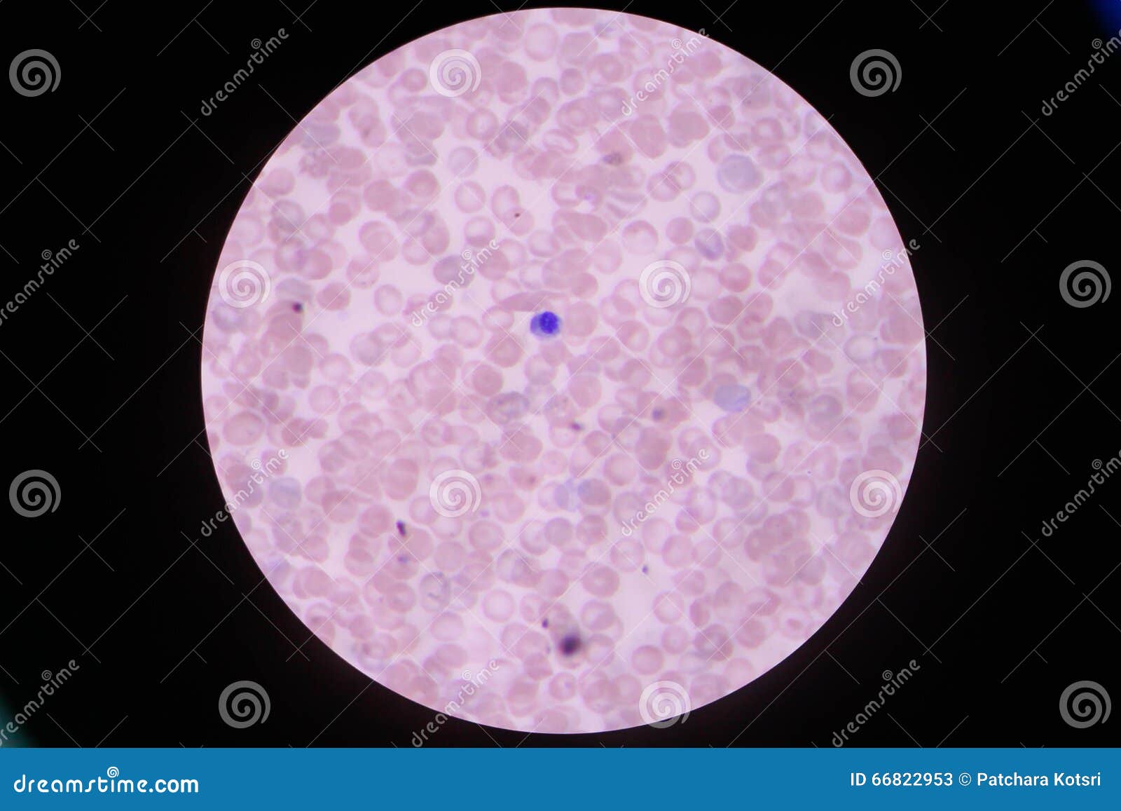 Nucleated Red Blood Cells NRC In Blood Smear Stock Photo ...