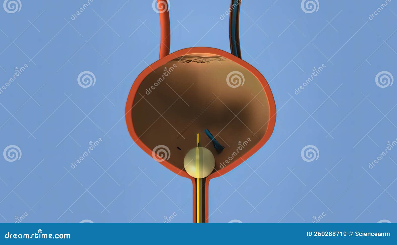 Stend Insertion between the Urinary Tract and Kidney Stock Illustration ...