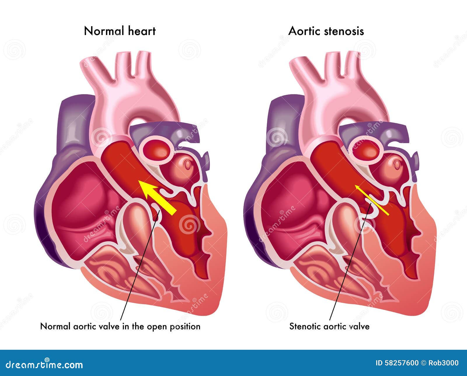 Stenosi aortica illustrazione di stock. Illustrazione di perdita - 58257600