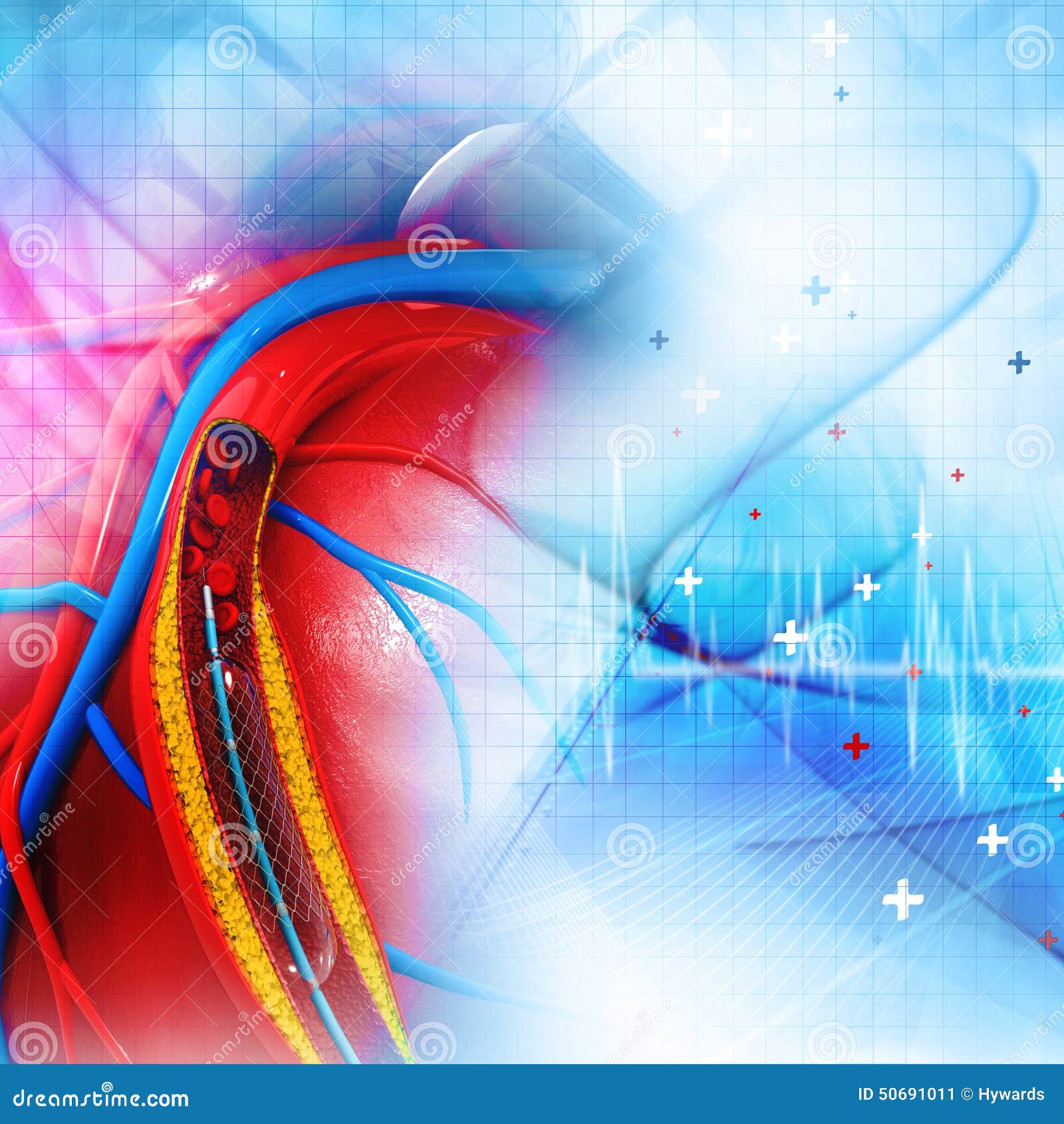 Stent Angioplasty. Peripheral Artery Disease Royalty-Free Cartoon ...