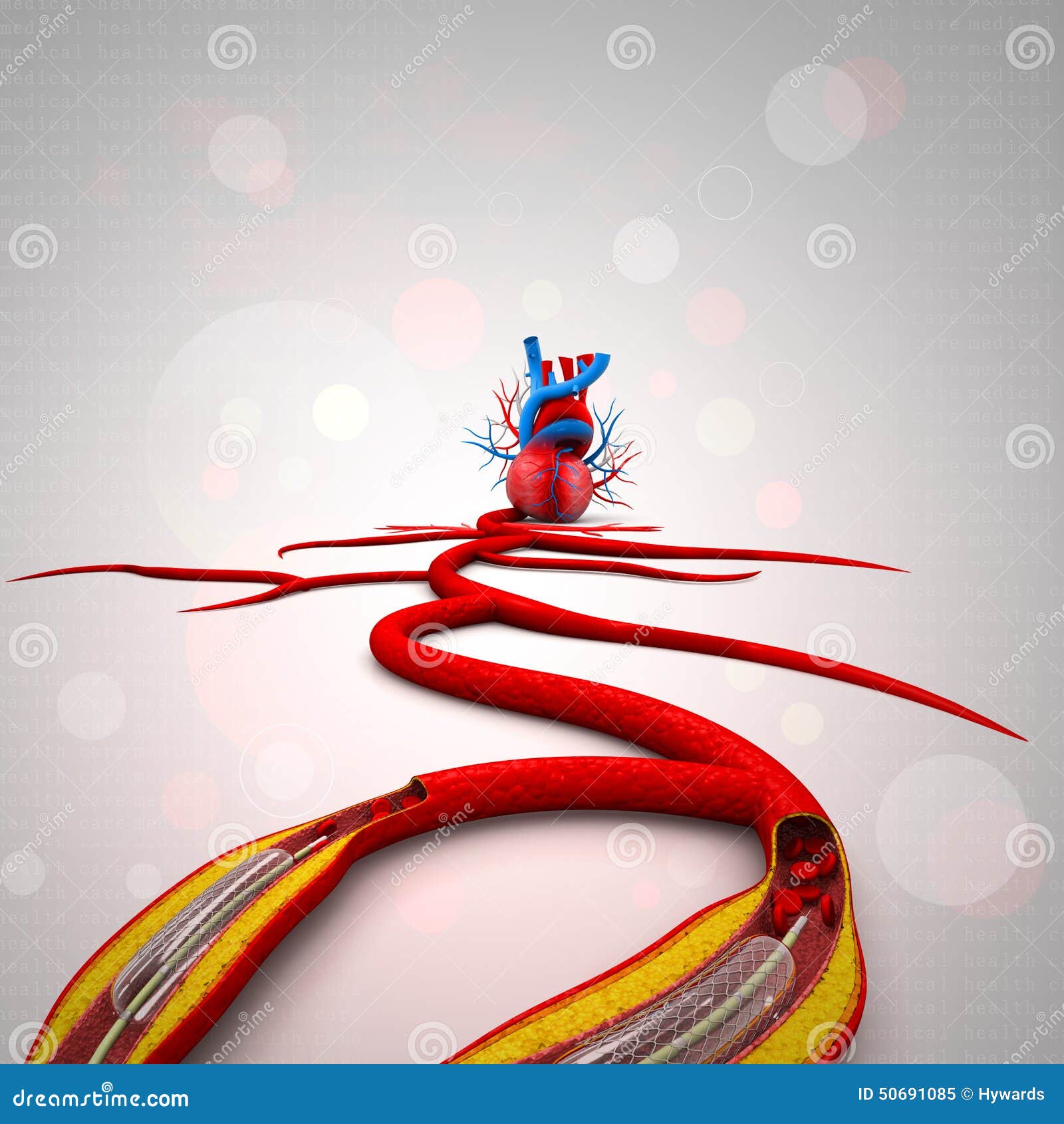 Stent Angioplasty. Peripheral Artery Disease Royalty-Free Cartoon ...