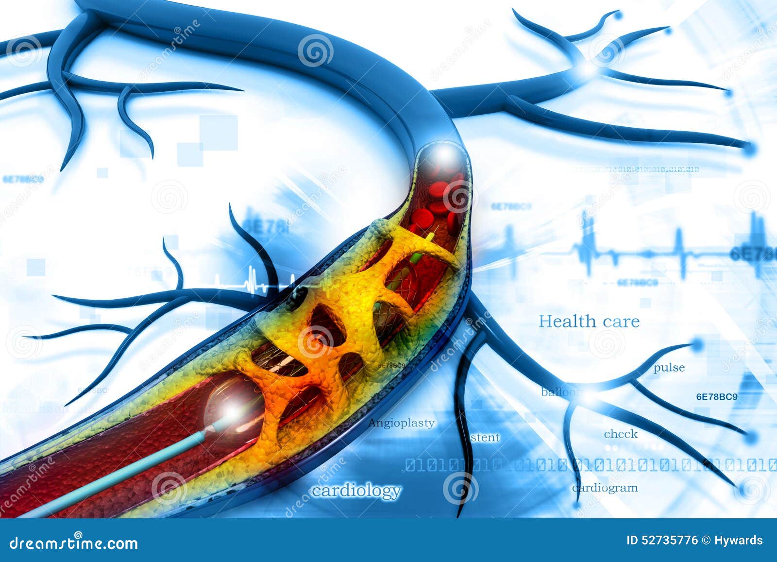 Stent Angioplasty. Peripheral Artery Disease Royalty-Free Cartoon ...