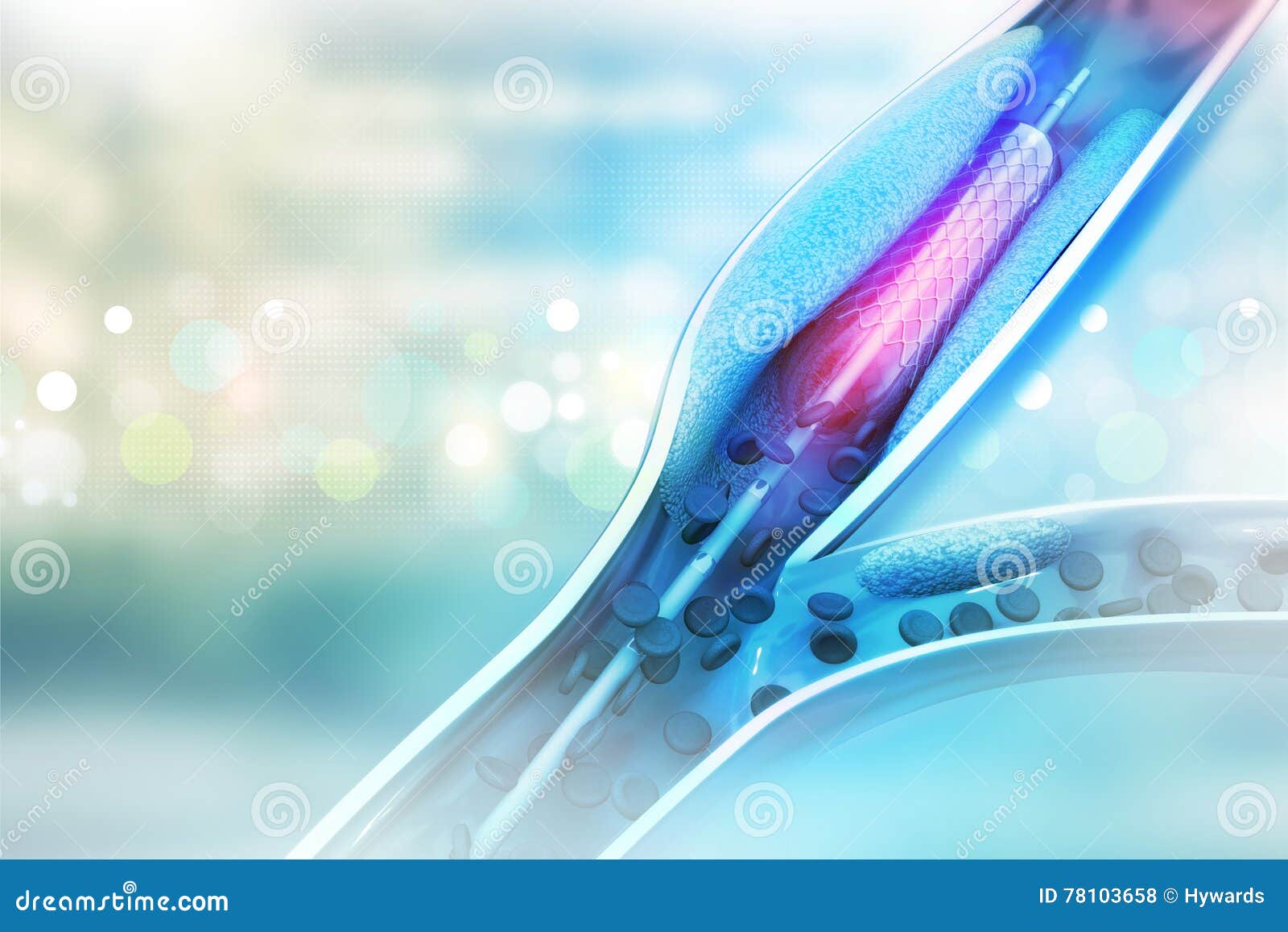 Stent angioplasty stock illustration. Illustration of clamp - 78103658
