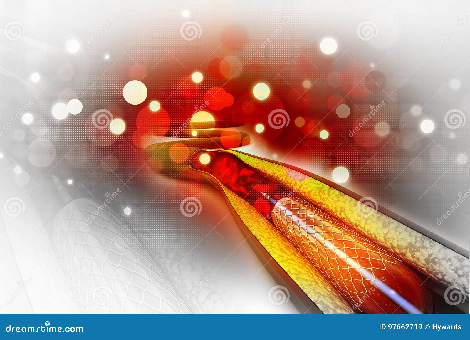 Stent Angioplasty. Peripheral Artery Disease Royalty-Free Cartoon ...