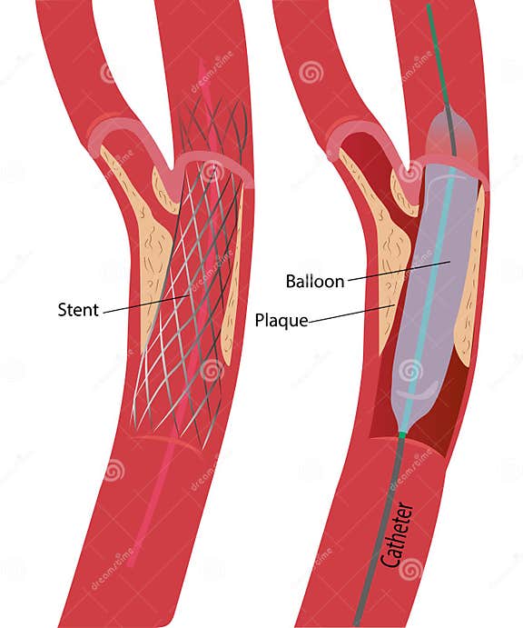 Angioplasty, Endovascular Surgery. Stent, Balloon, Medical Illustration ...