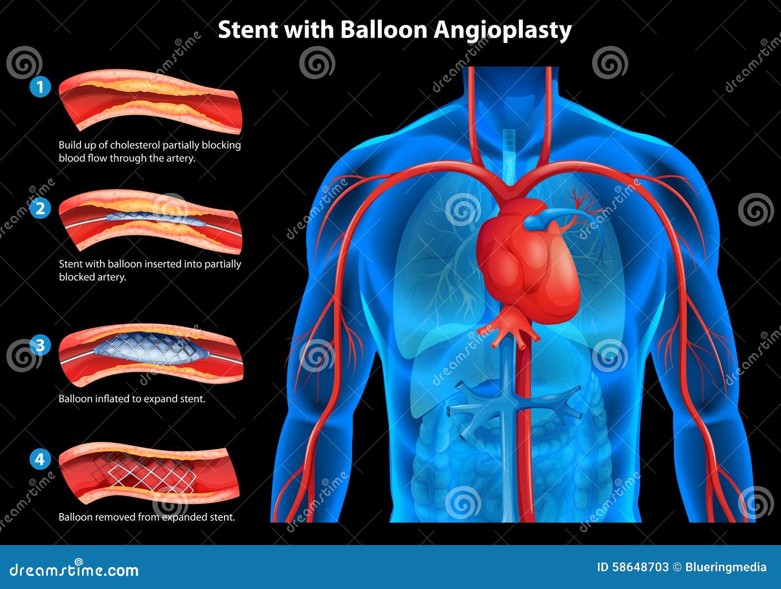 Balloon Angioplasty Procedure Royalty-Free Stock Photo | CartoonDealer ...