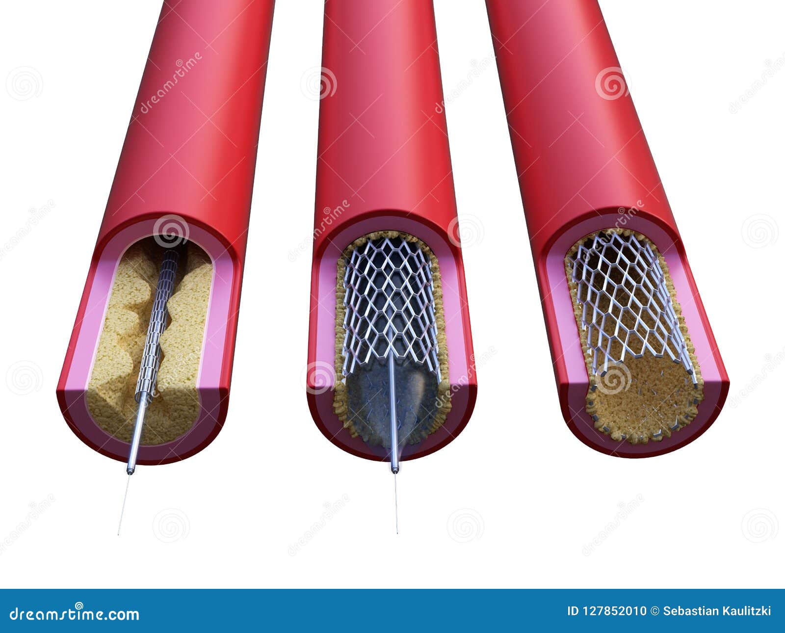 Stent Placed In An Artery Royalty-Free Cartoon | CartoonDealer.com ...