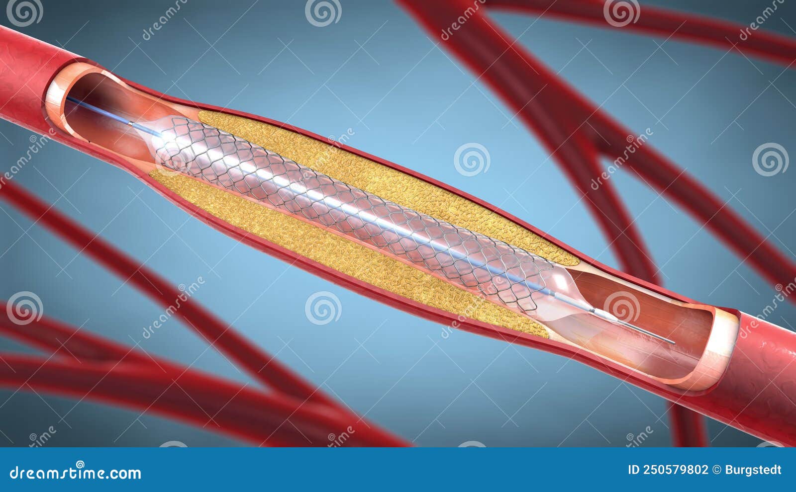 Illustration Of Stent Implantation To Support Blood Flow Into The Blood ...