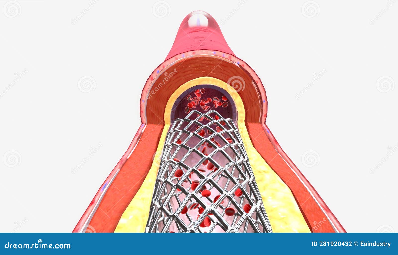 Stent Insertion into Artery Narrowed from Plaque Stock Illustration ...