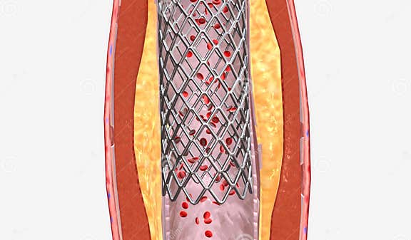 Stent Insertion into Artery Narrowed from Plaque Stock Illustration ...