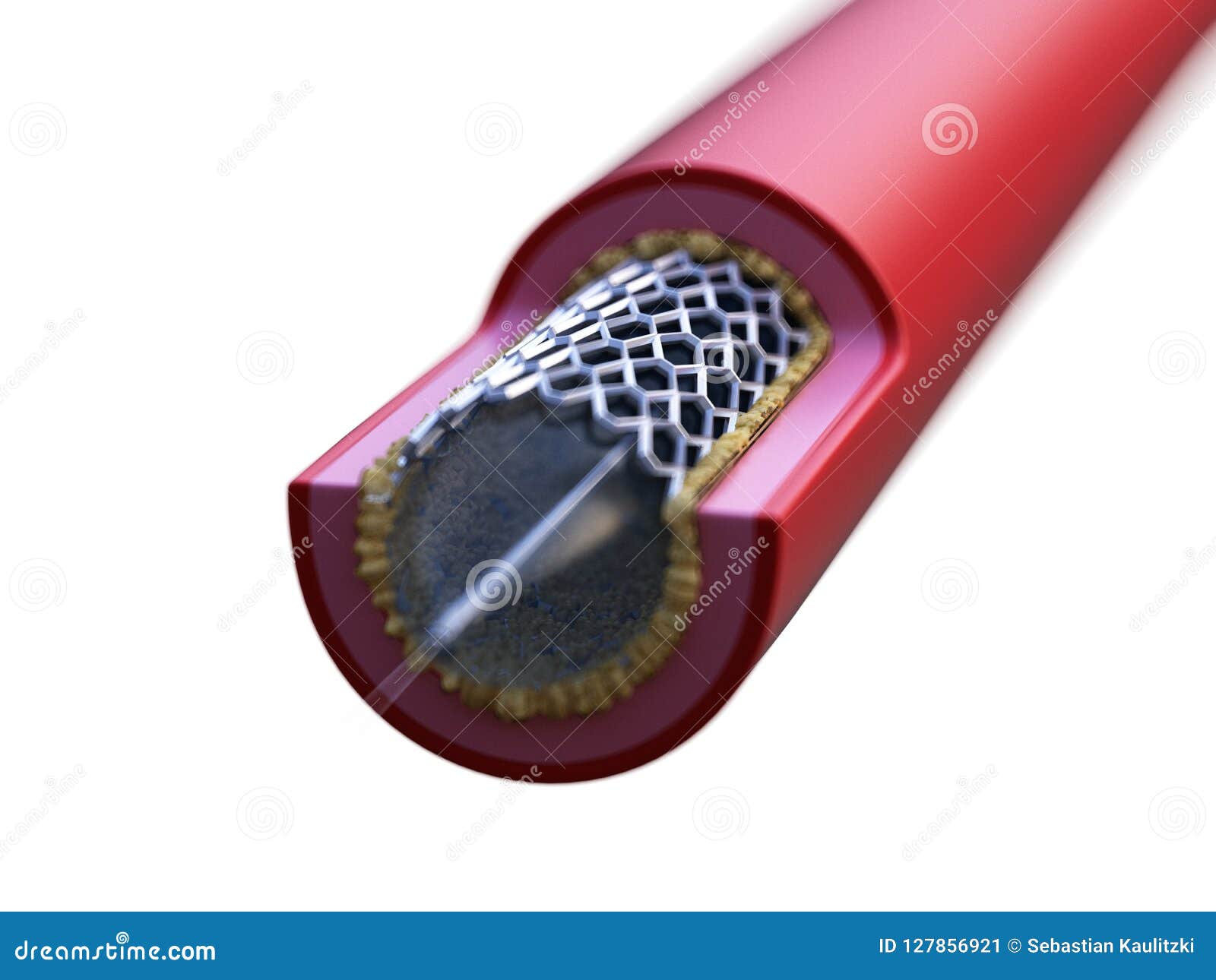 Stent Placed In An Artery Royalty-Free Cartoon | CartoonDealer.com ...