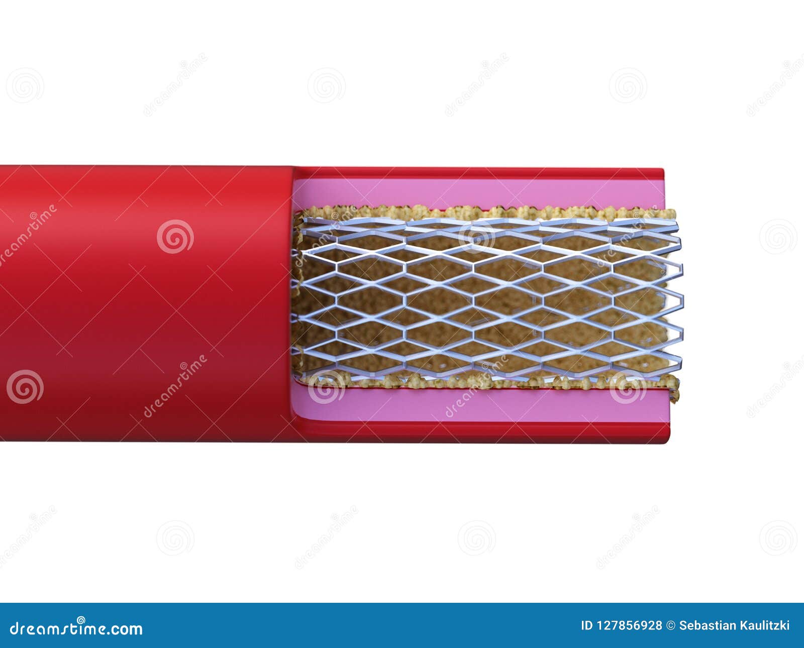 Stent Placed In An Artery Royalty-Free Cartoon | CartoonDealer.com ...