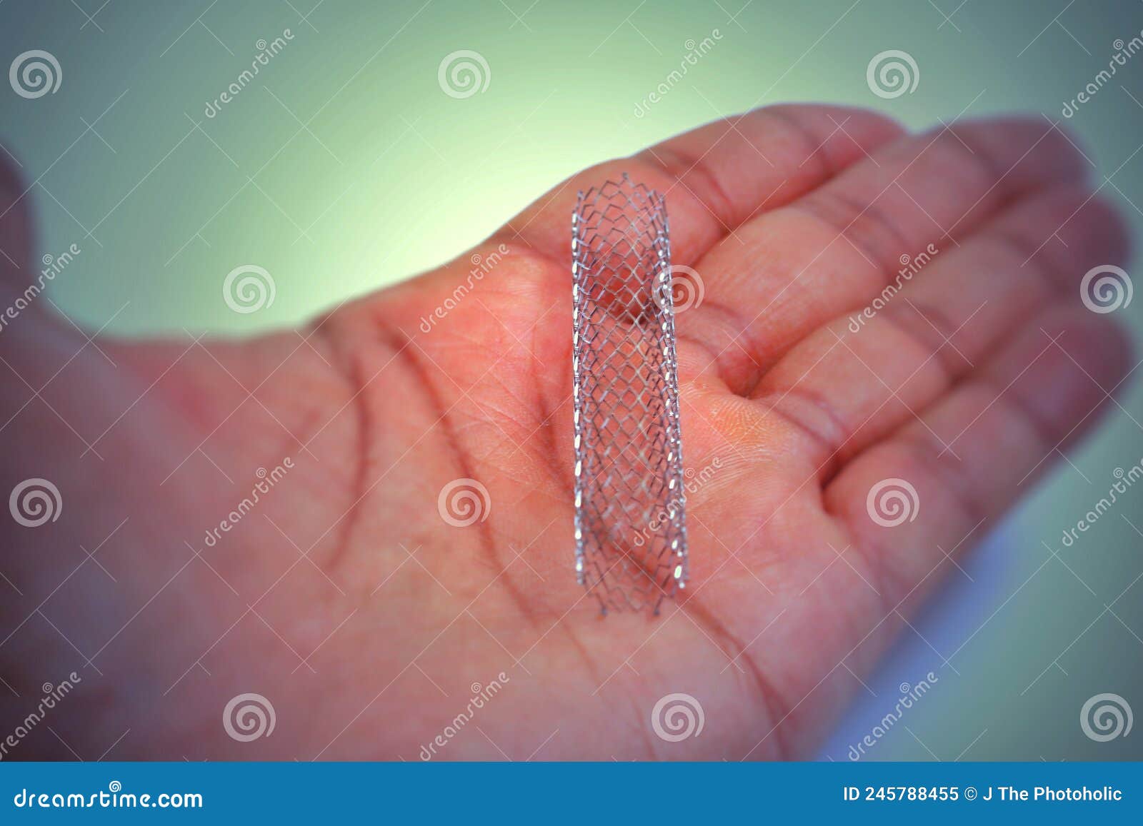 Angioplasty. Stent Implantation. Deflated Balloon Catheter Inserted ...