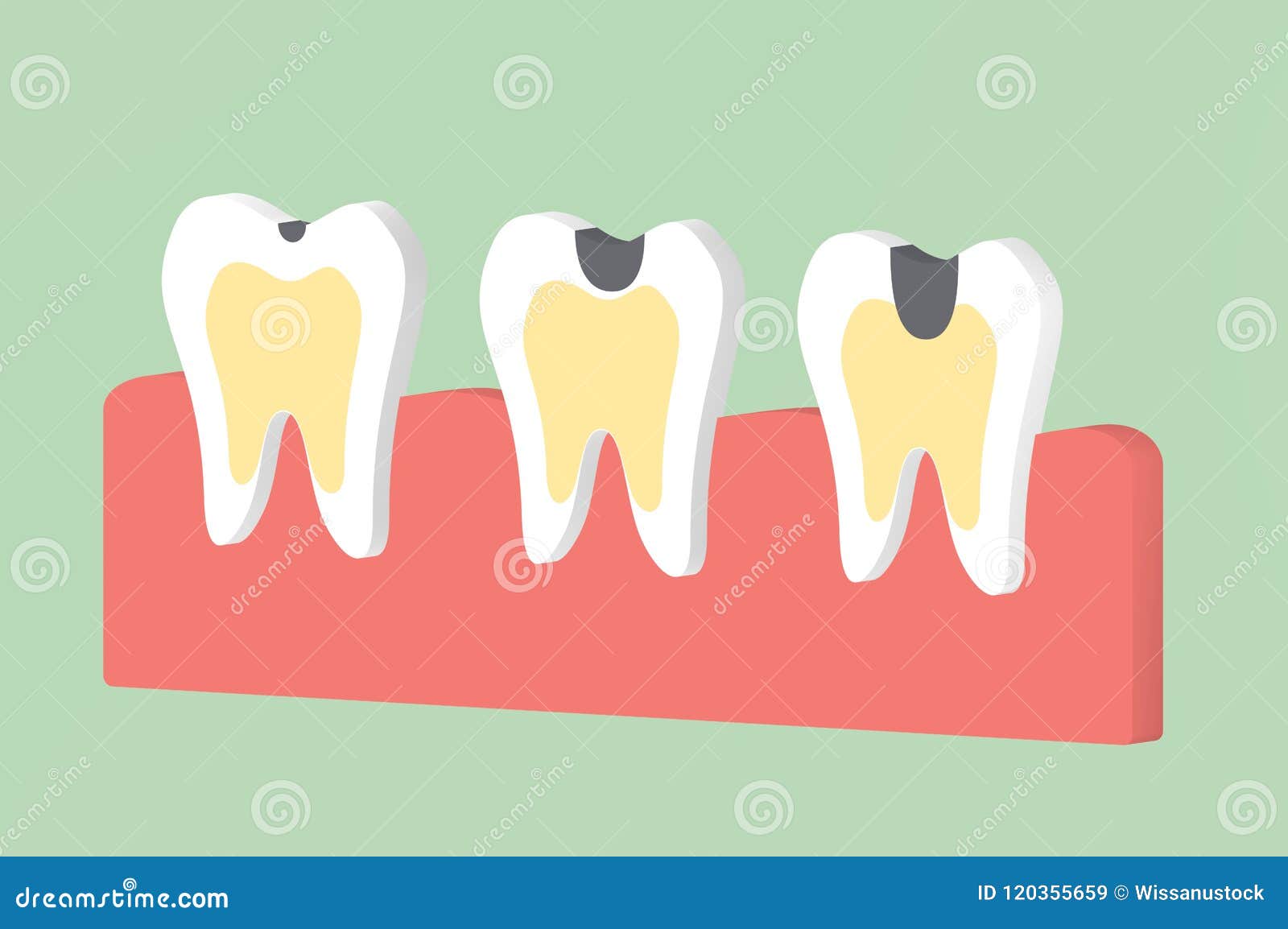 Step Of Tooth Decay Formation. Cartoon Vector | CartoonDealer.com ...