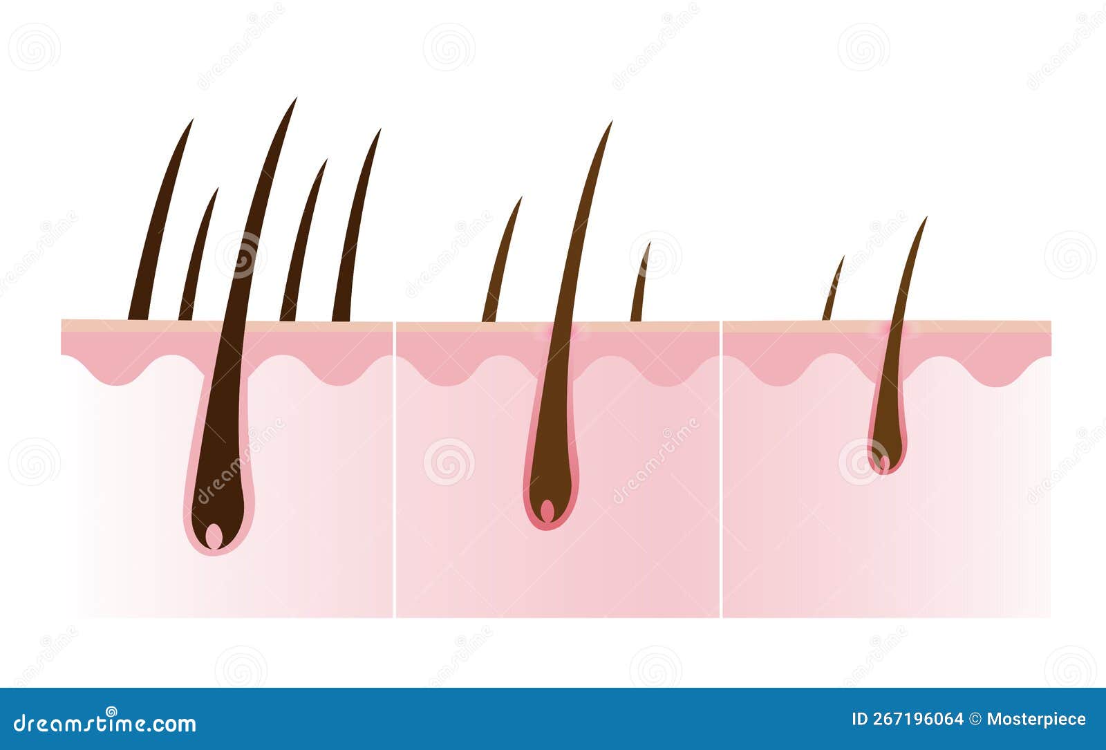 Step Of Hair Losing With Scalp Layer Vector Illustration Isolated On ...
