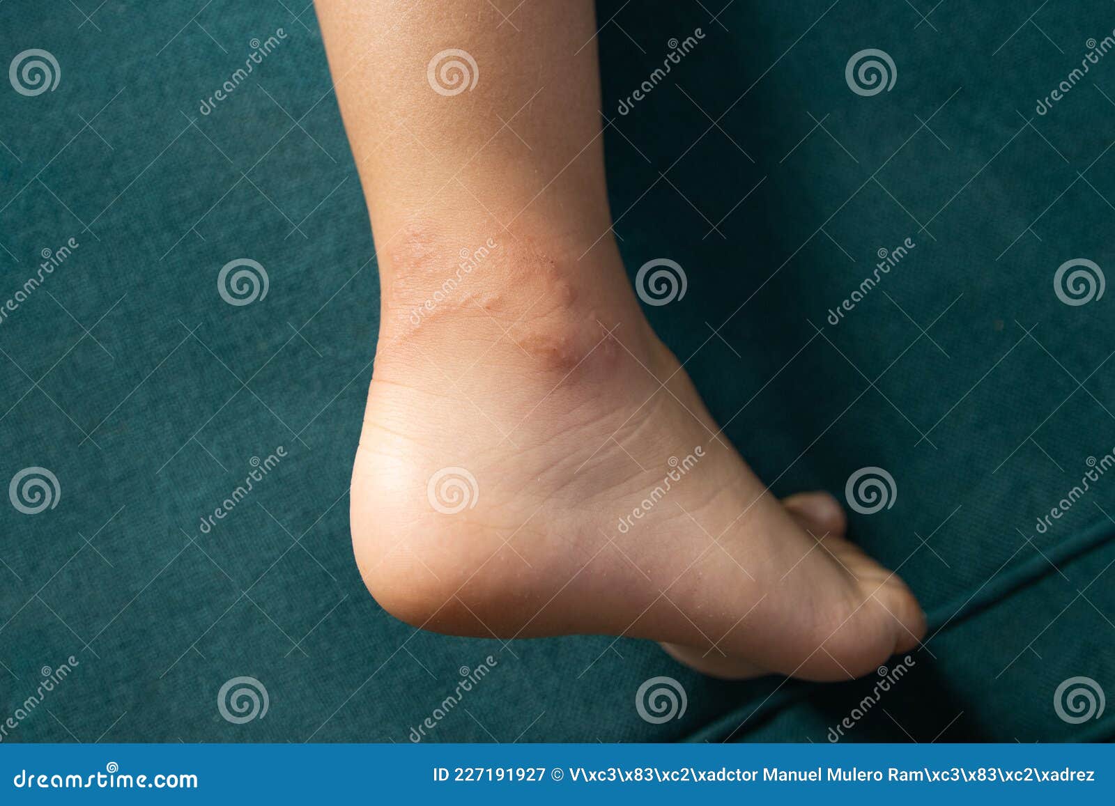 Baby Jellyfish Sting