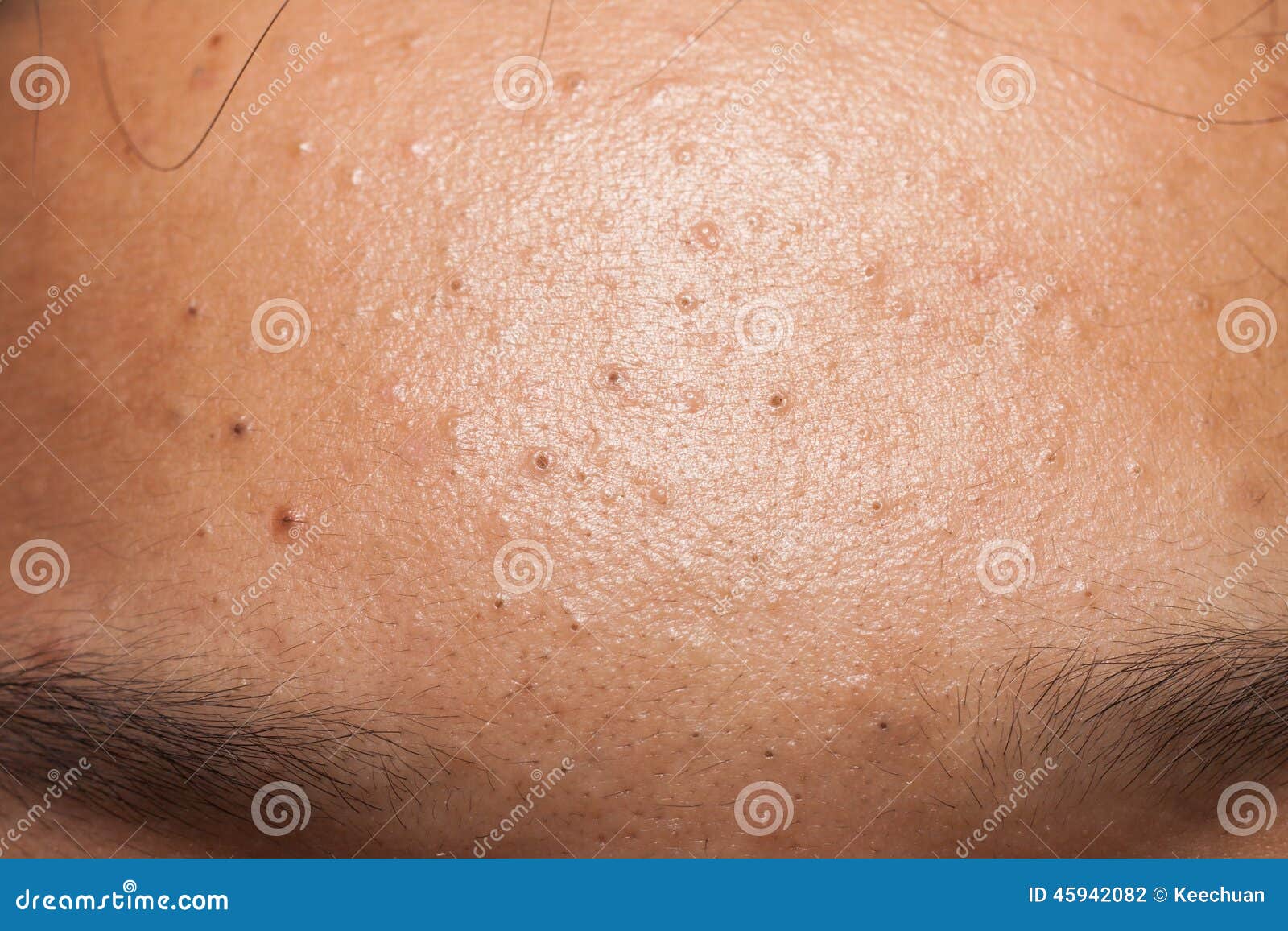 Stirn mit vielen Mitessern stockfoto. Bild von schönheit - 45942082