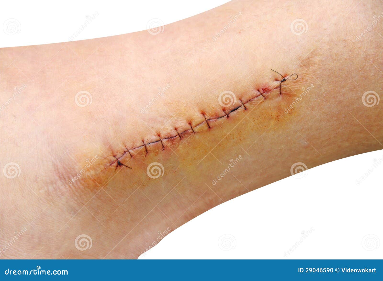 Stitch stock photo. Image of patient, flesh, damage, scabbing - 29046590