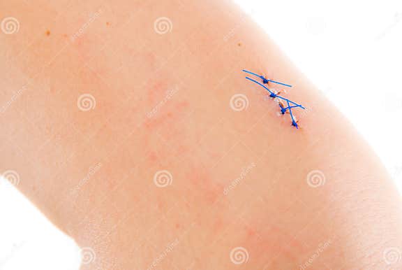Stitched up injury stock photo. Image of hurt, hand, body - 13325534