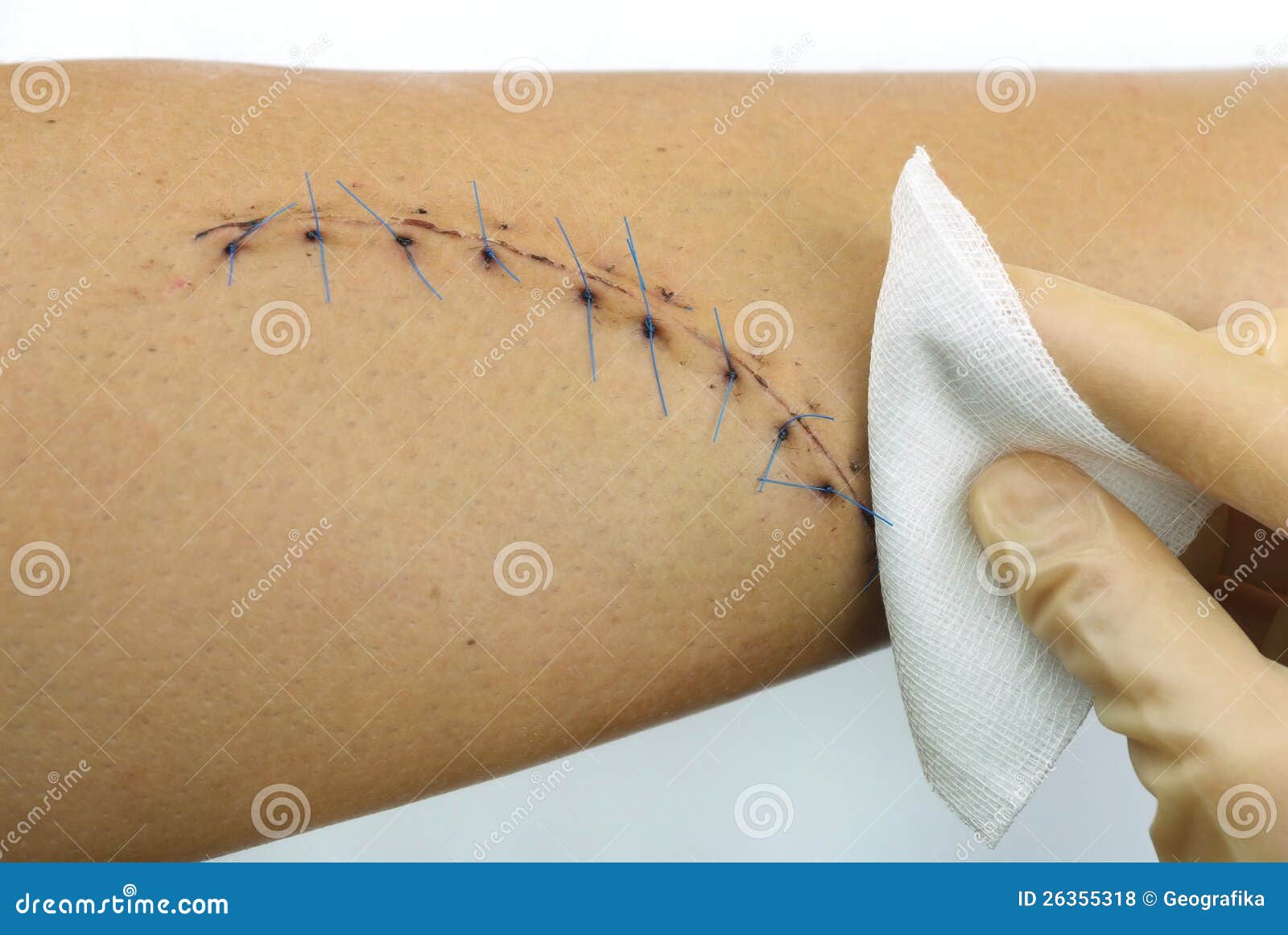 Stitched wound stock photo. Image of cure, damage, scab - 26355318