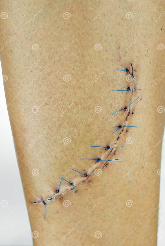 Stitched wound stock photo. Image of hospital, accident - 26355324