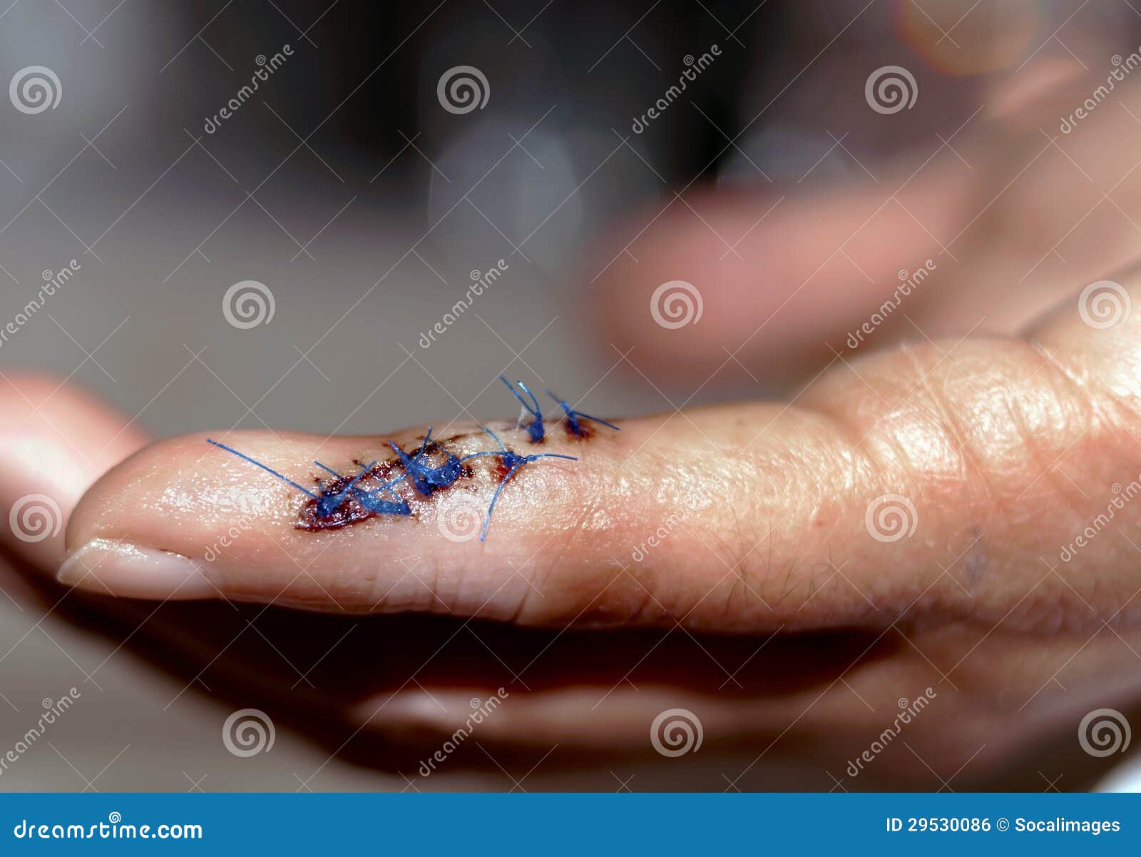 Stitches stock photo. Image of treatment, blue, heal - 29530086