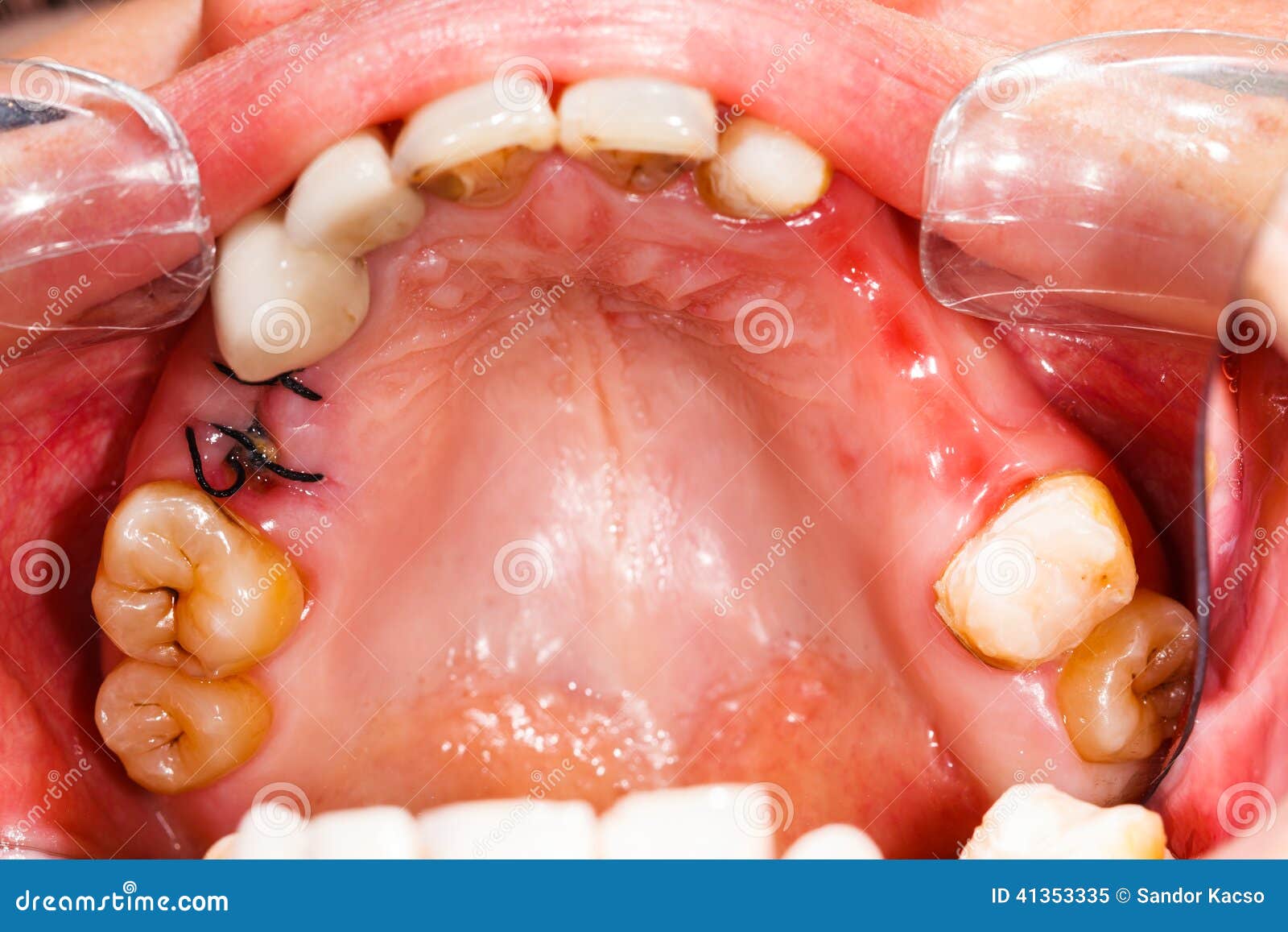 Stitches after Extraction stock image. Image of gums - 41353335 Stitches after Extraction stock image. Image of gums - 41353335