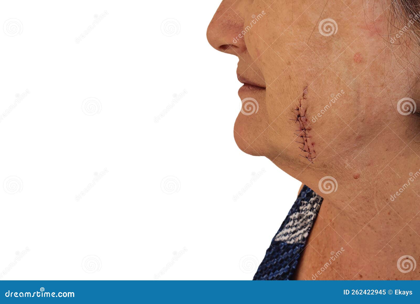 Stitches on Side of Face from a Mole Cut Out Stock Image - Image of ...