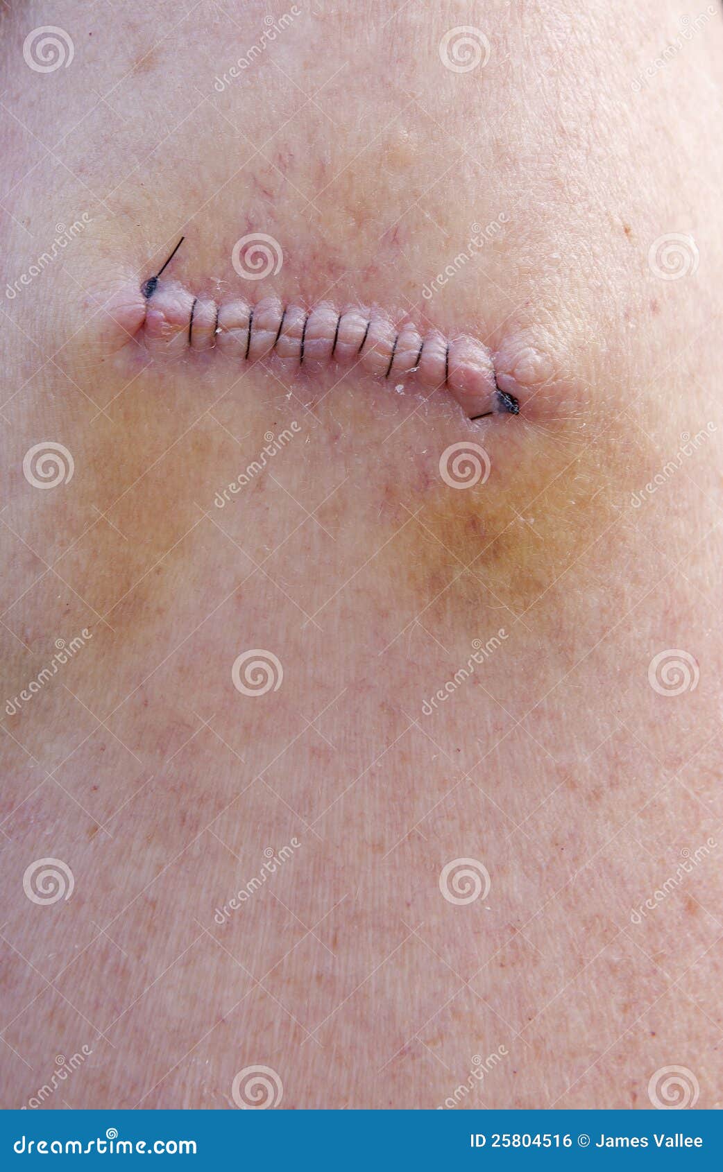Stitches after Skin Cancer Removal Stock Photo - Image of close, cancer ...
