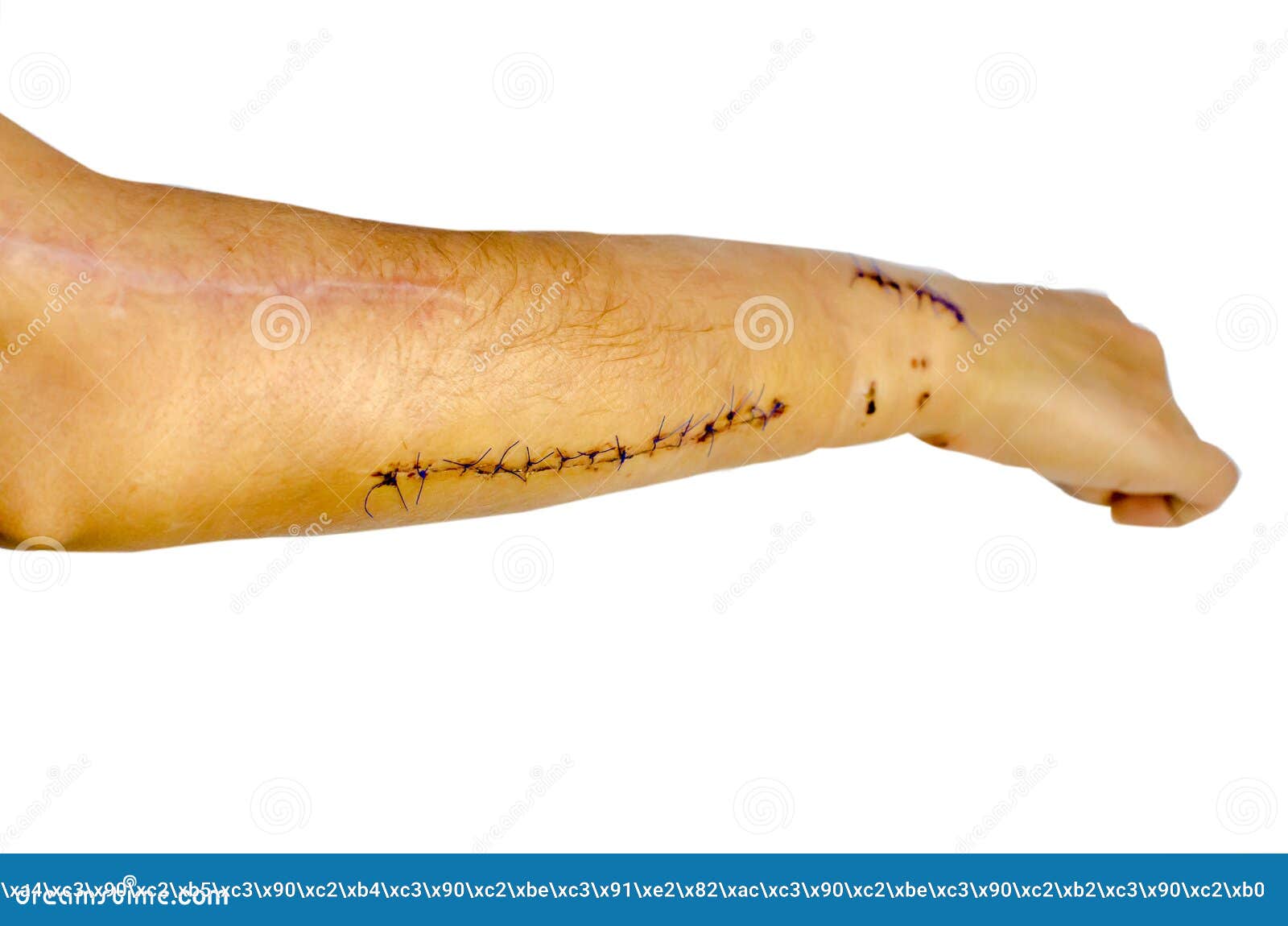 Stitches after Surgery Isolated Background Stock Image - Image of ...