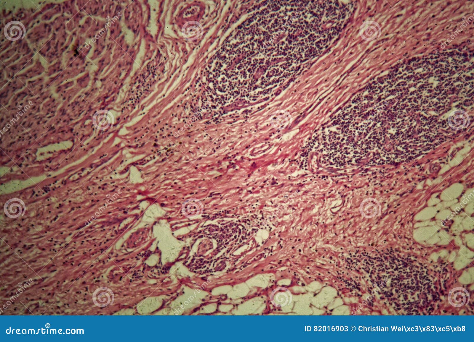 Stomach Cancer Cells Under the Microscope. Stock Image - Image of ...