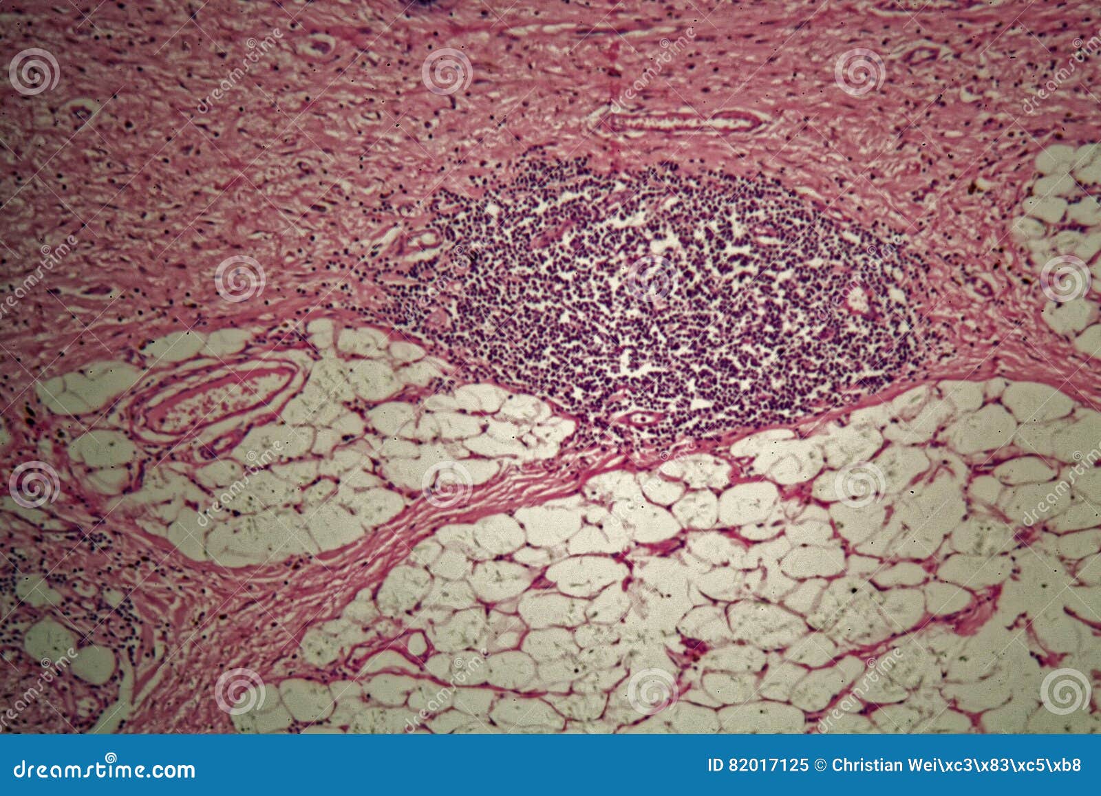 Stomach Cancer Cells Under the Microscope. Stock Image - Image of ...