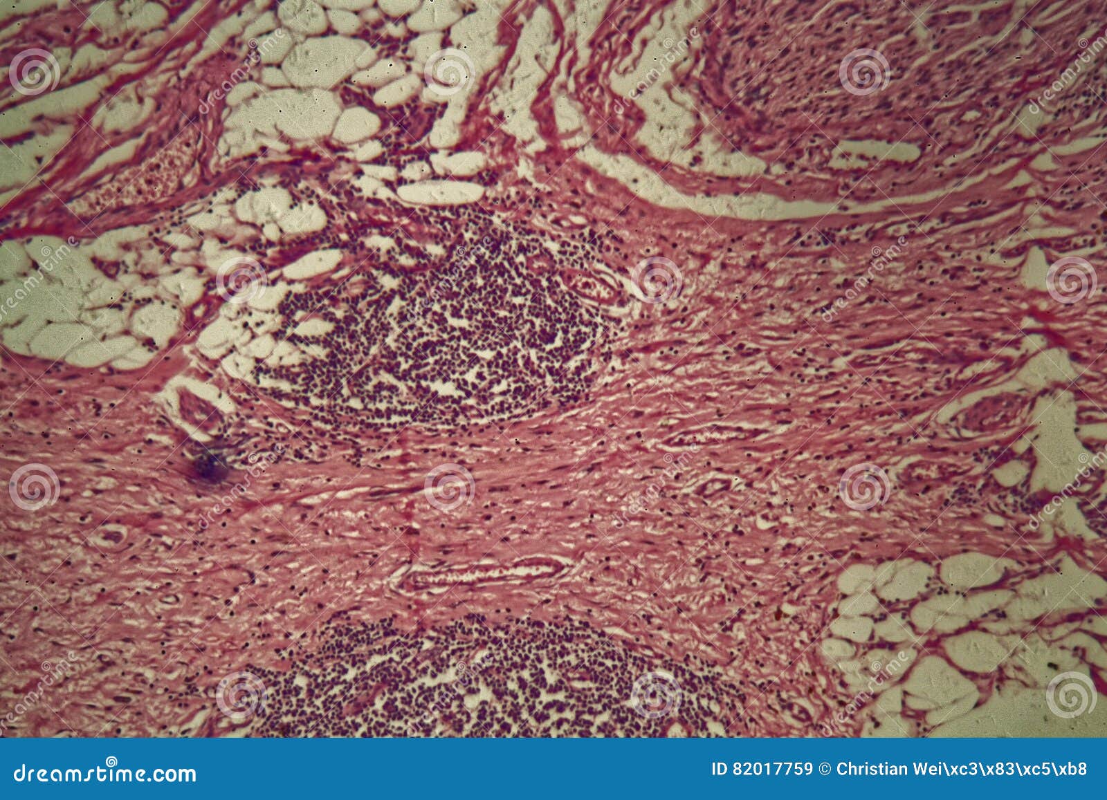 Stomach Cancer Cells Under the Microscope. Stock Image - Image of ...