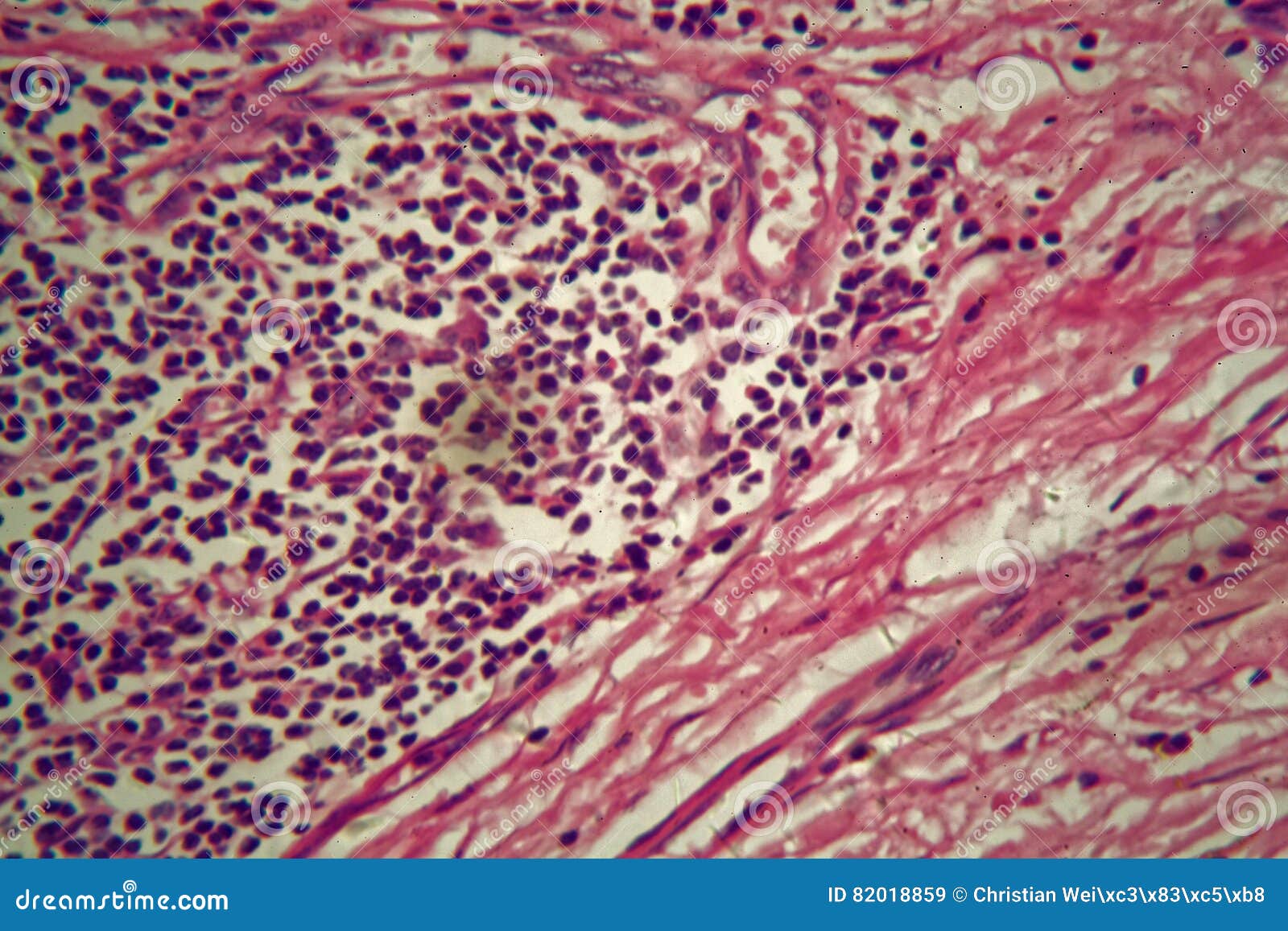 Stomach Cancer Cells