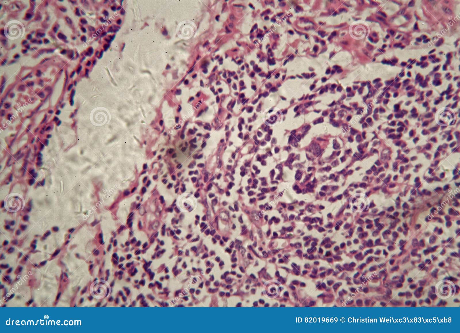 Colon Cancer Cells Under Microscope