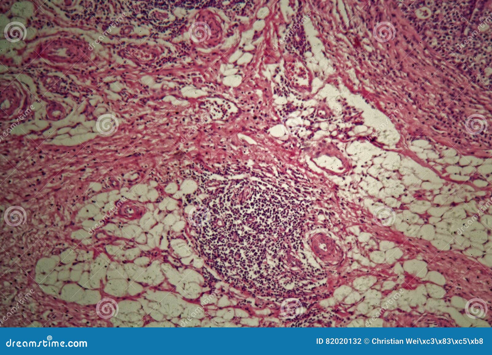 Human Cancer Cells Under A Microscope