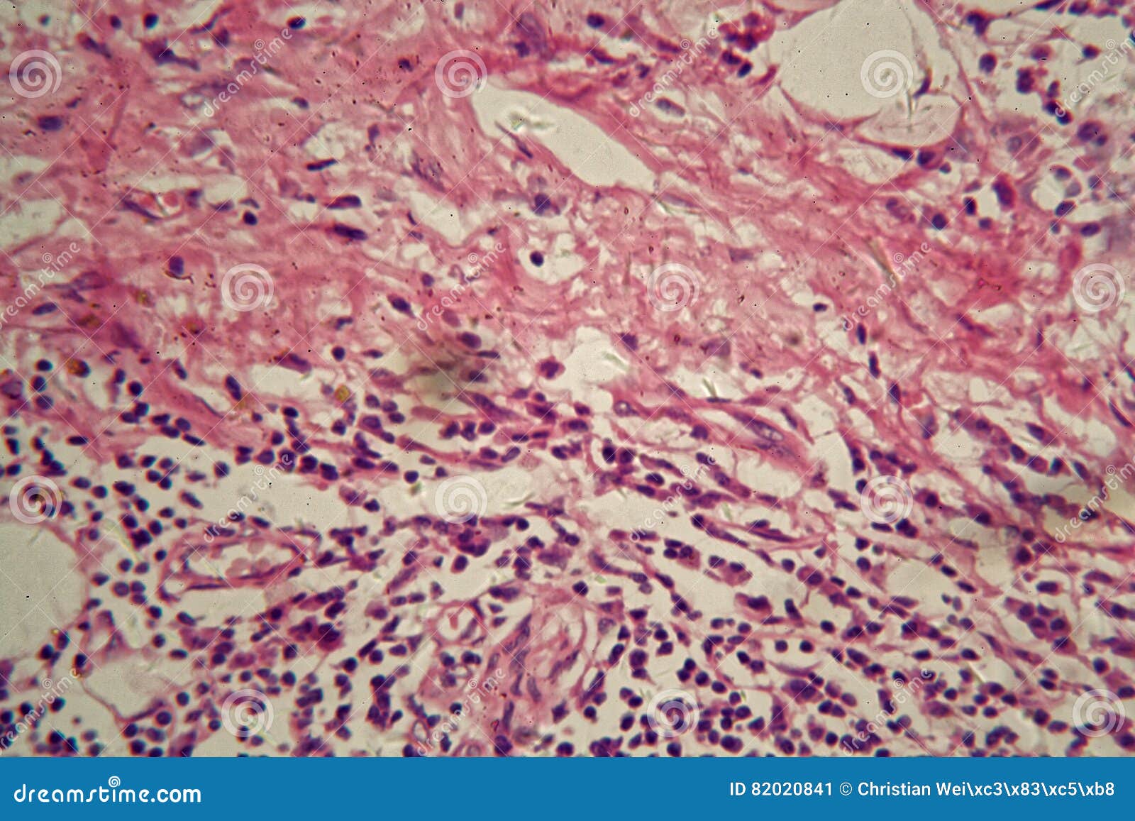 Stomach Cancer Cells Under the Microscope. Stock Image - Image of death ...