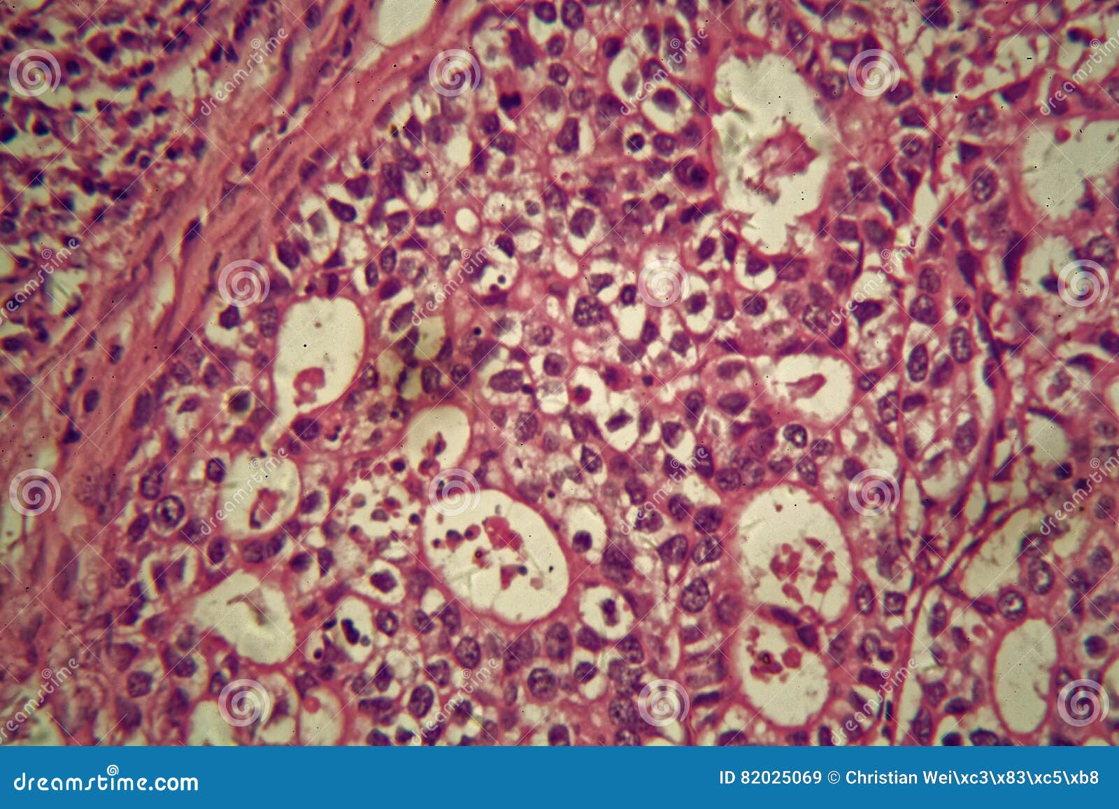 Stomach Cancer Cells Under The Microscope. Royalty-Free Stock ...